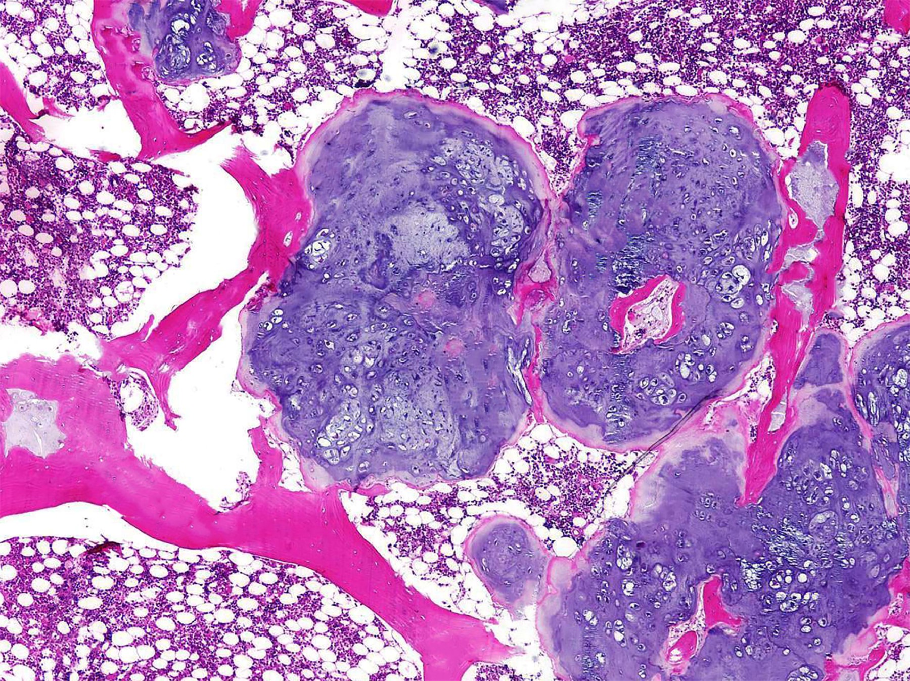 Pathology Outlines - Enchondroma