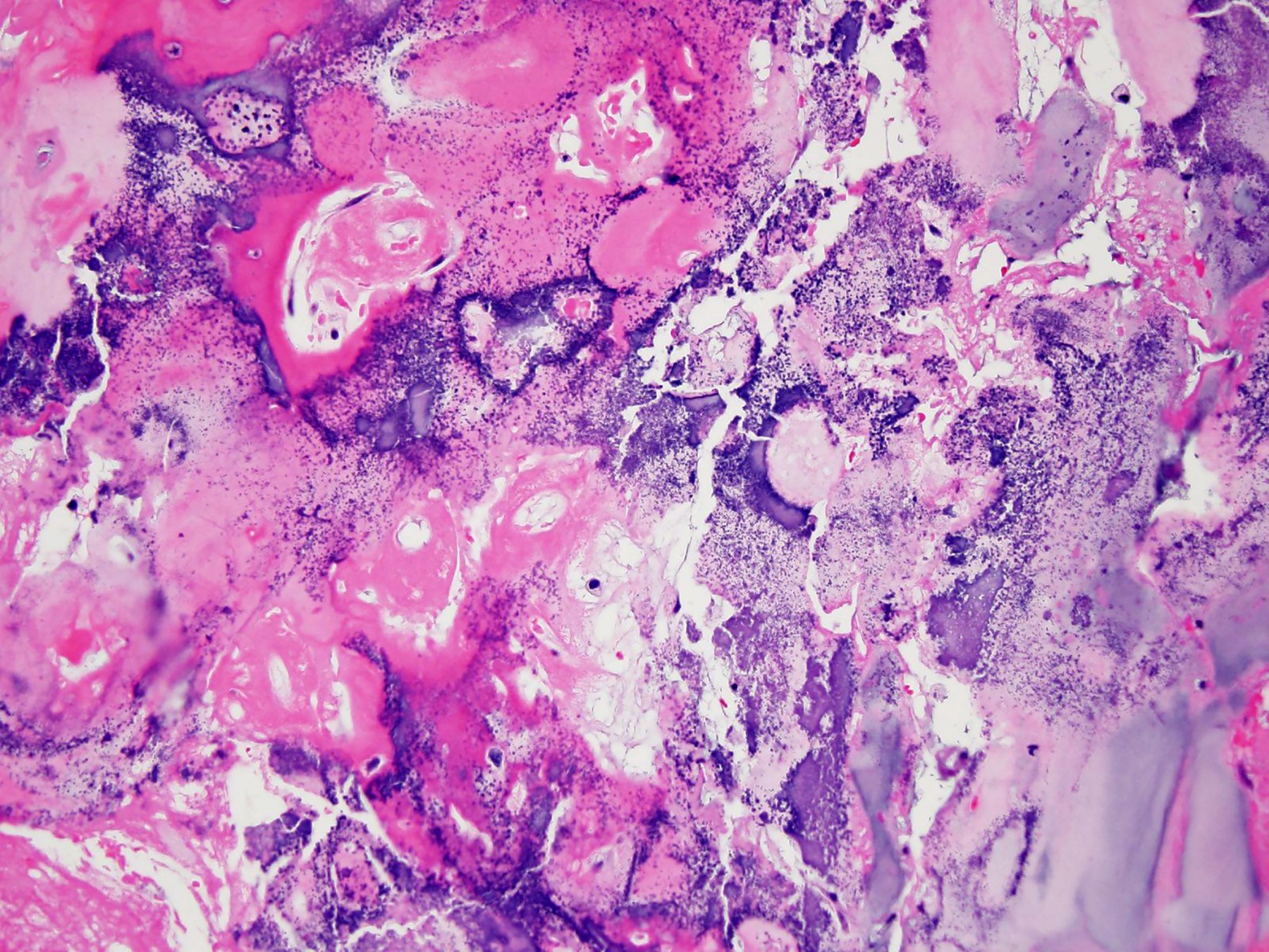 Multiple Enchondromatosis Histology