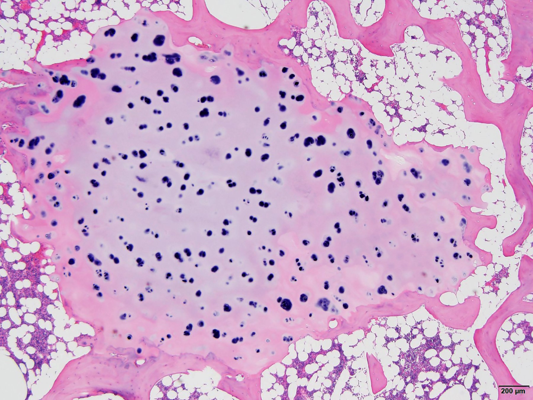 Pathology Outlines - Enchondroma