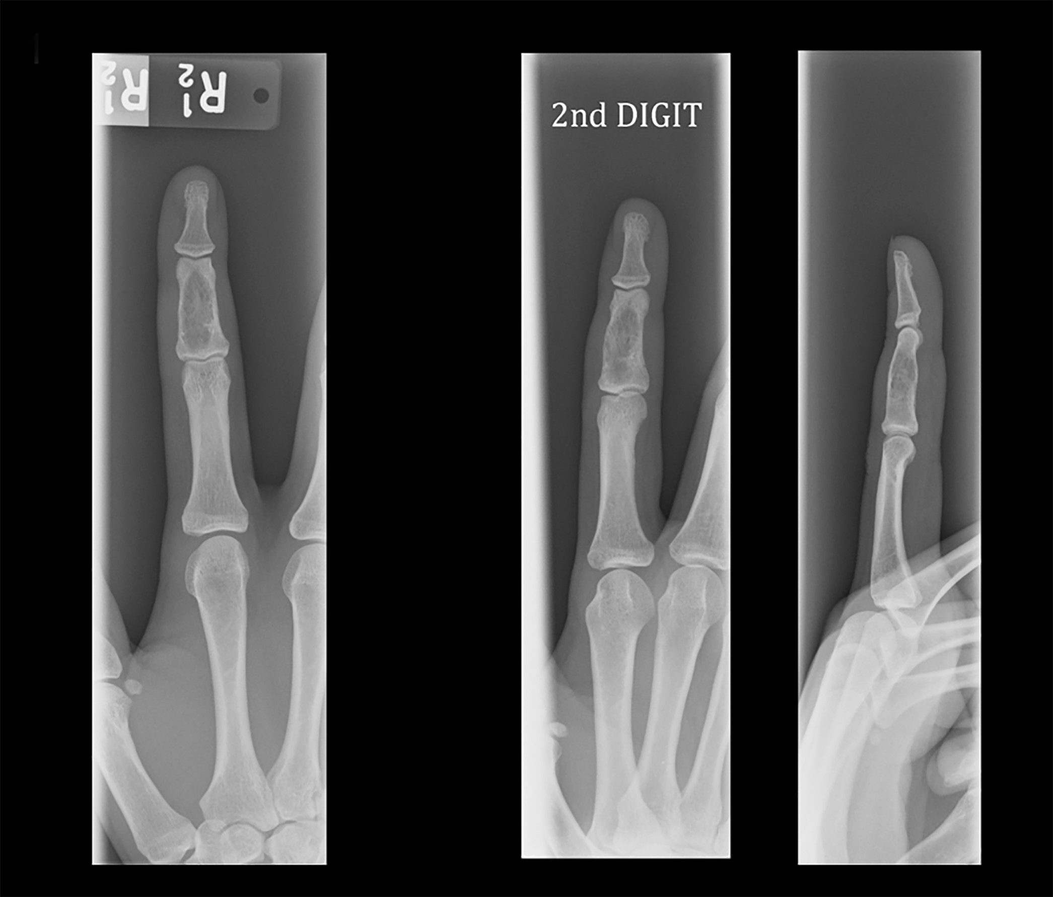 Pathology Outlines - Enchondroma