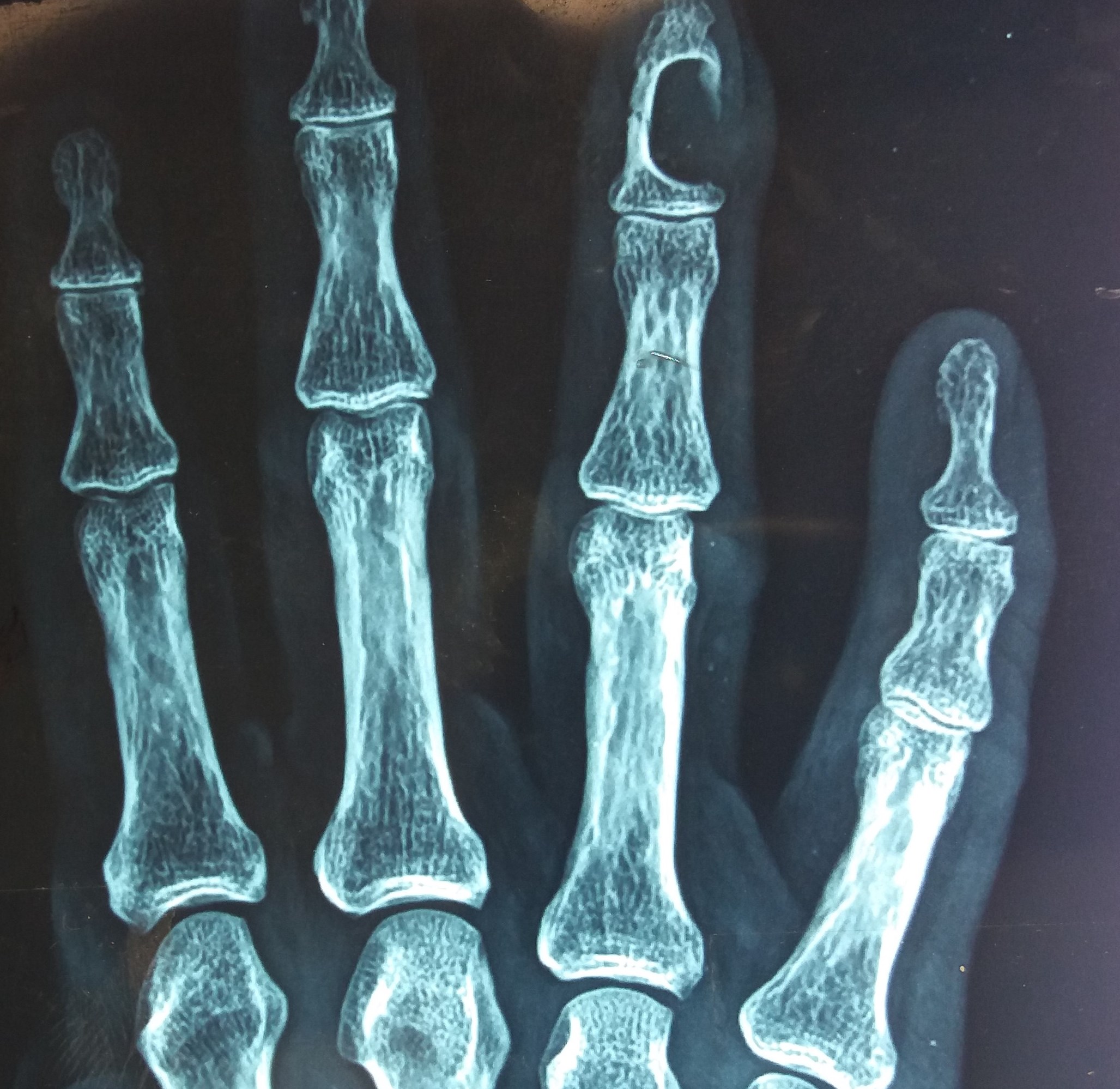 Pathology Outlines - Epidermoid inclusion cyst