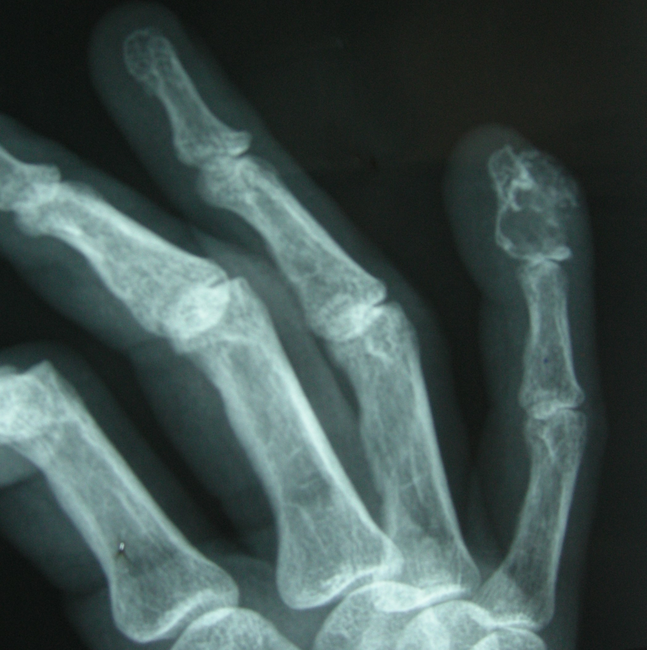 Pathology Outlines - Epidermoid inclusion cyst