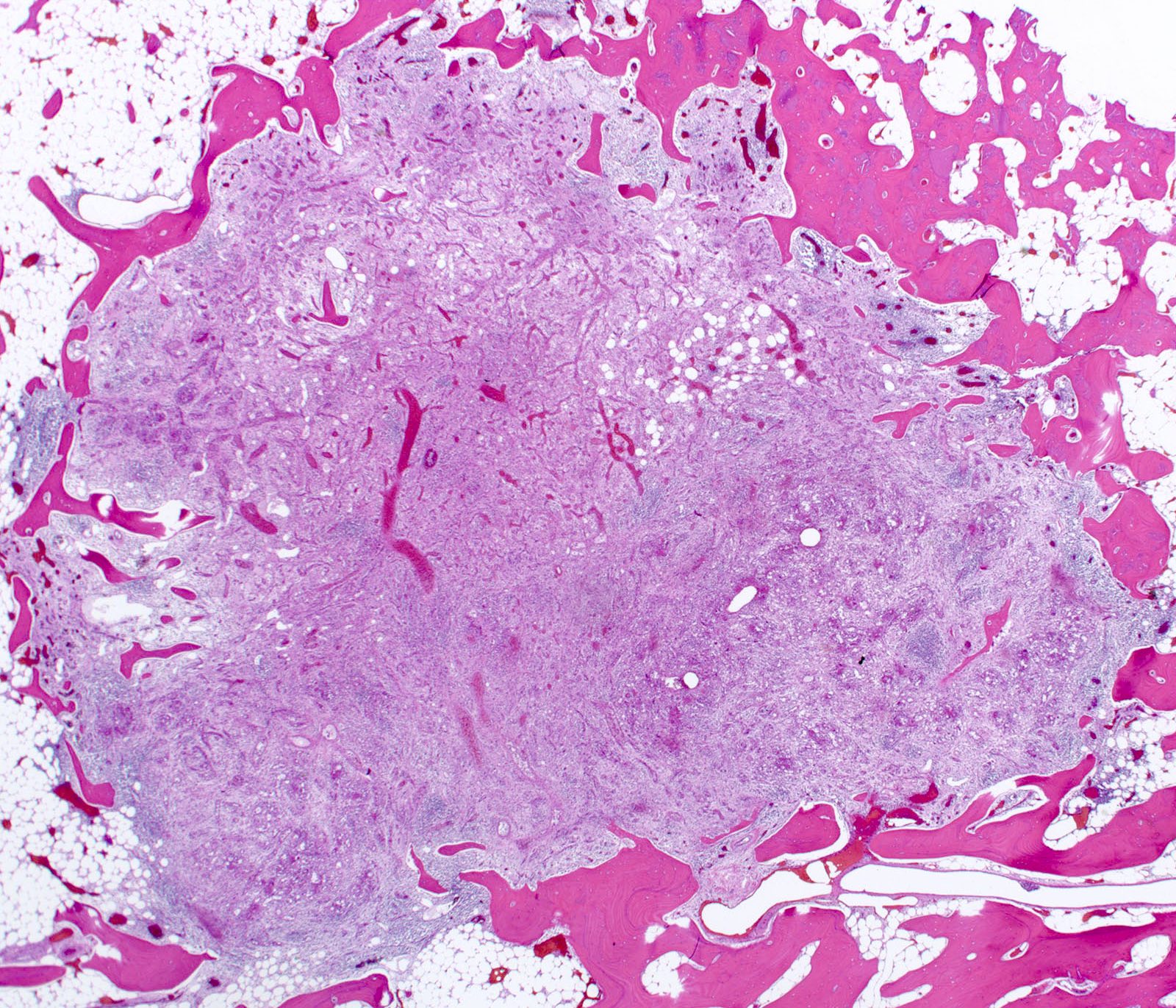 Pathology Outlines - Epithelioid hemangioma of bone