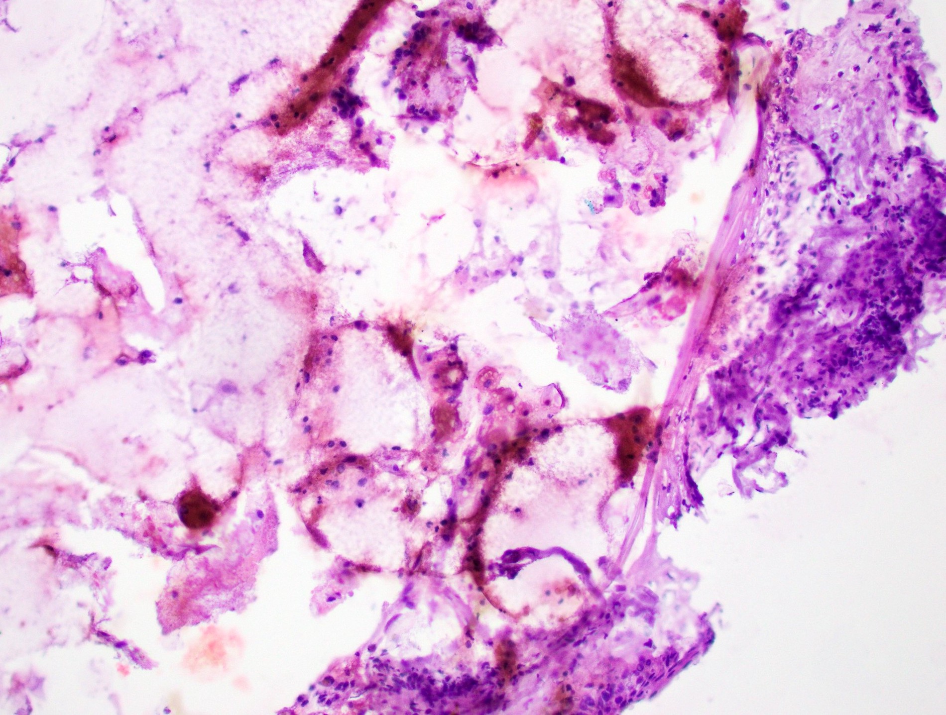 Pathology Outlines - Fracture