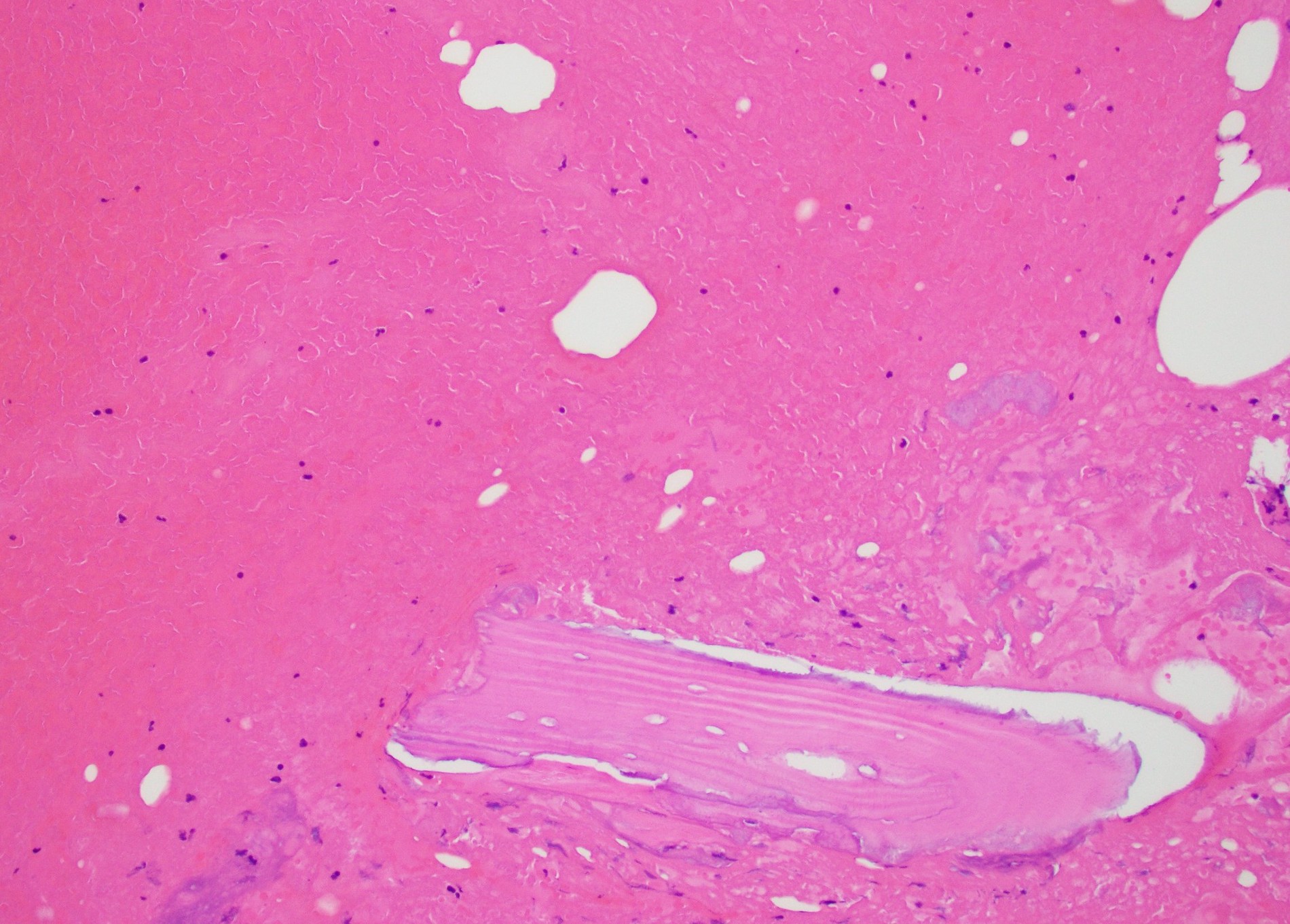 Pathology Outlines - Fracture