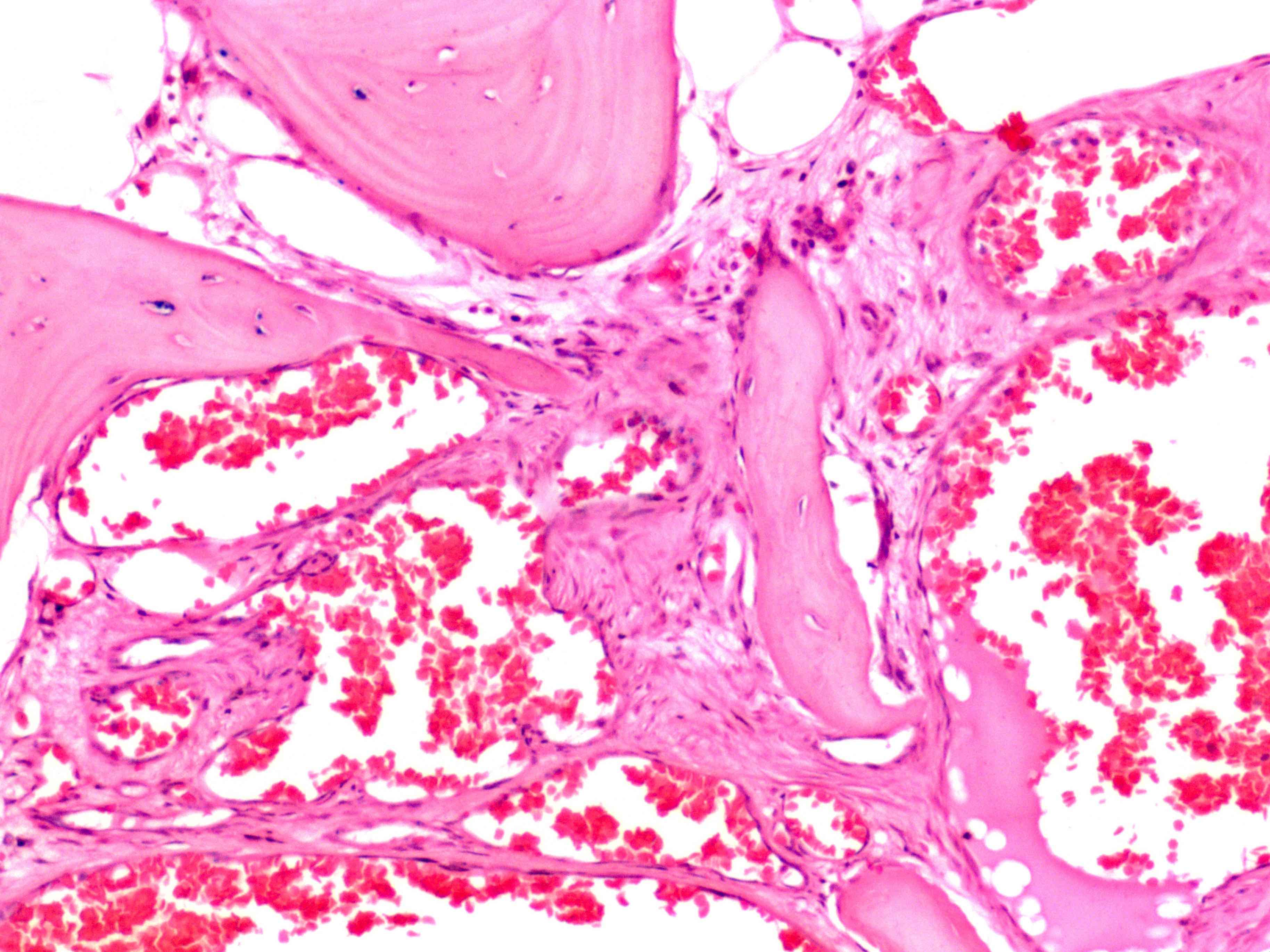 Pathology Outlines - Hemangioma