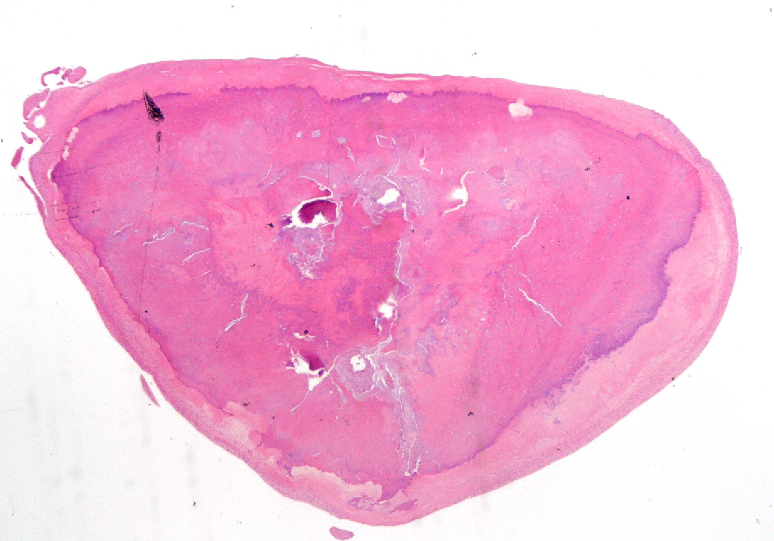 Pathology Outlines - Osteocartilaginous loose bodies