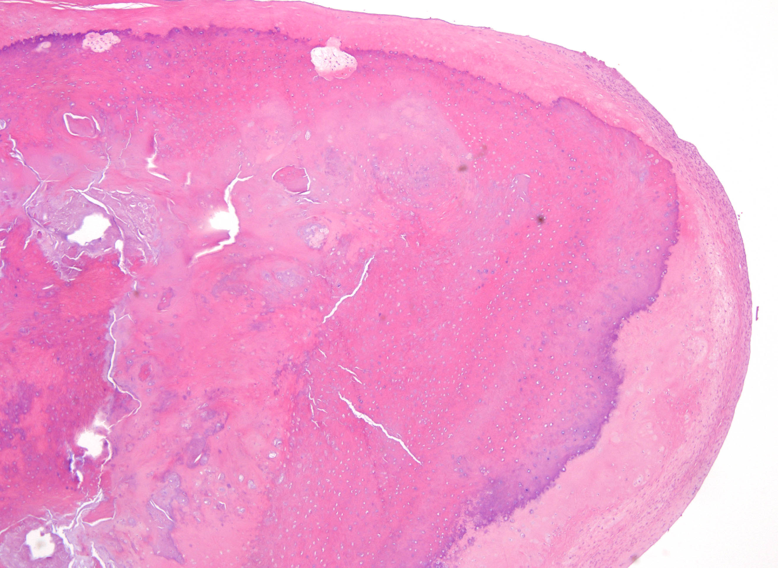 Pathology Outlines - Osteocartilaginous loose bodies