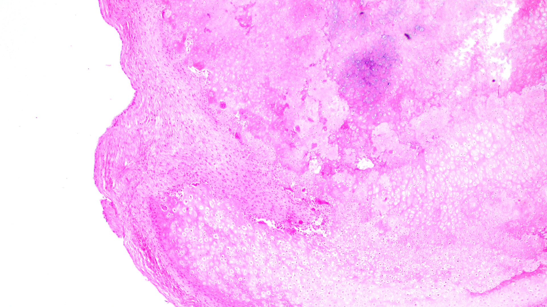 Pathology Outlines - Osteocartilaginous loose bodies