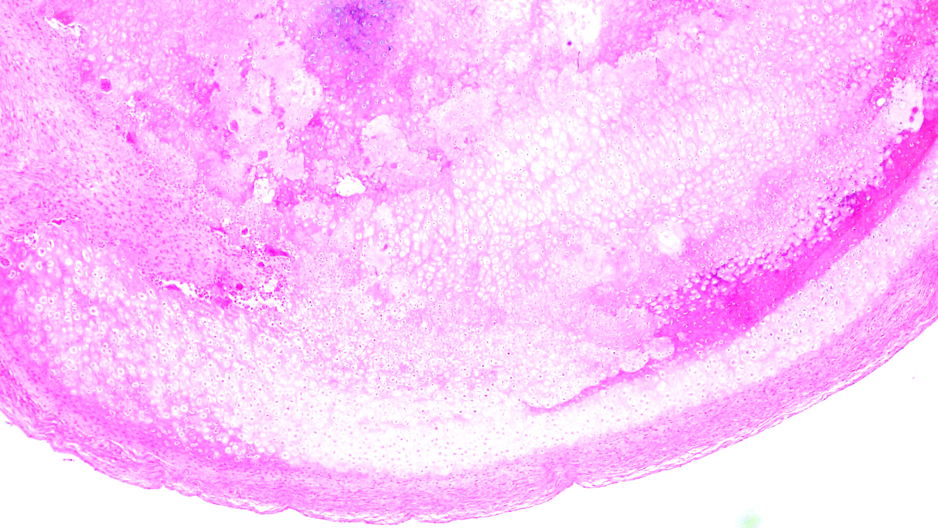 Pathology Outlines - Osteocartilaginous loose bodies
