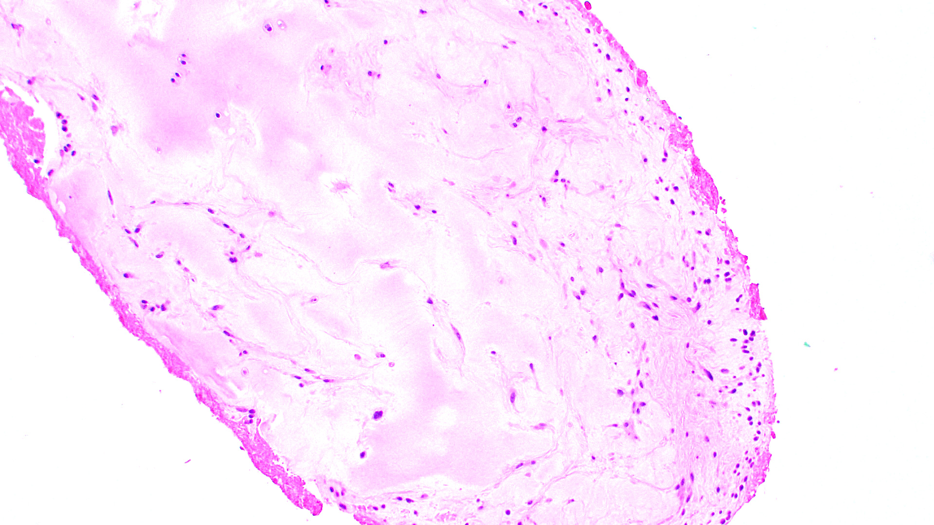 Pathology Outlines - Osteocartilaginous loose bodies