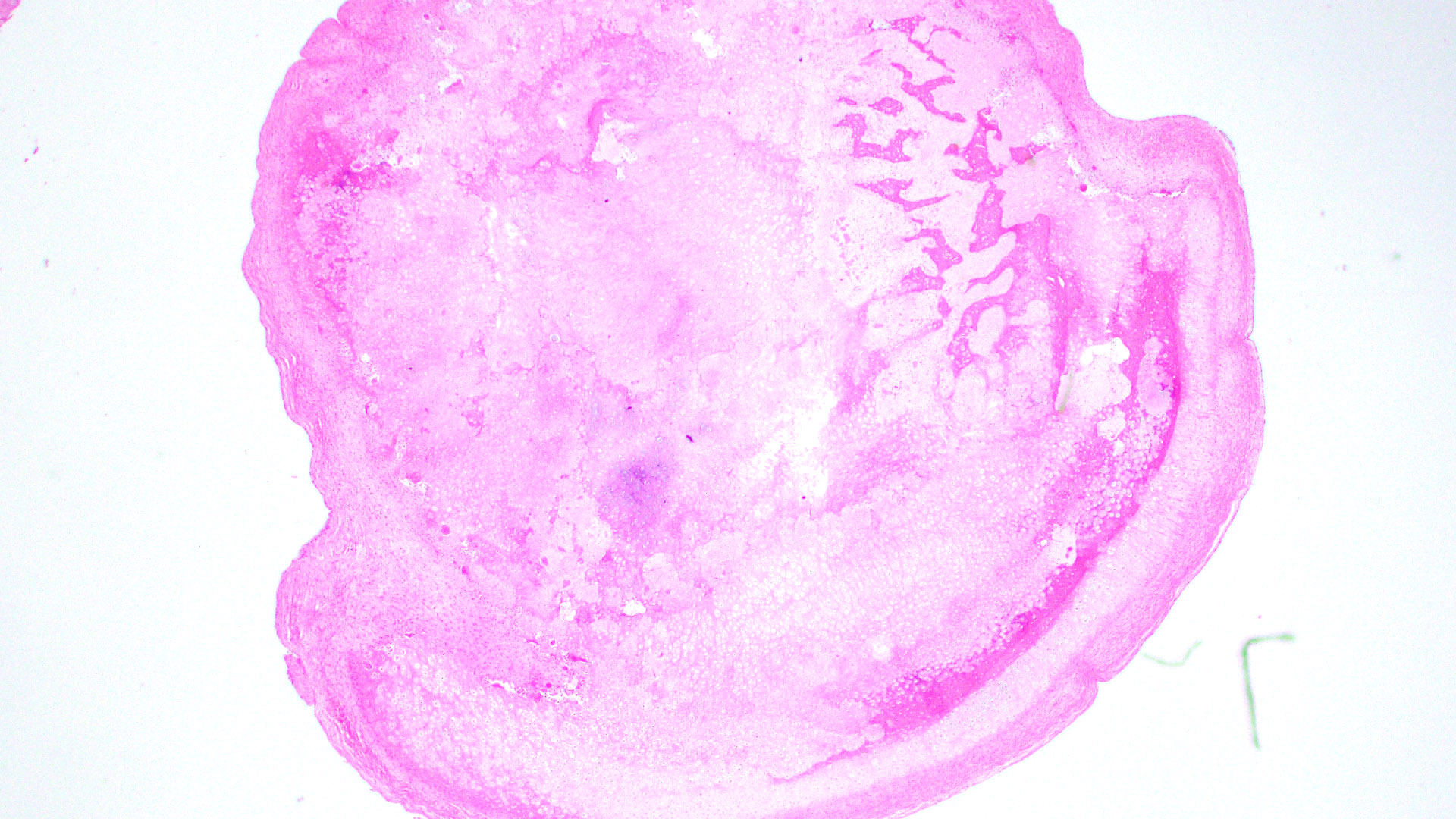 Pathology Outlines - Osteocartilaginous loose bodies