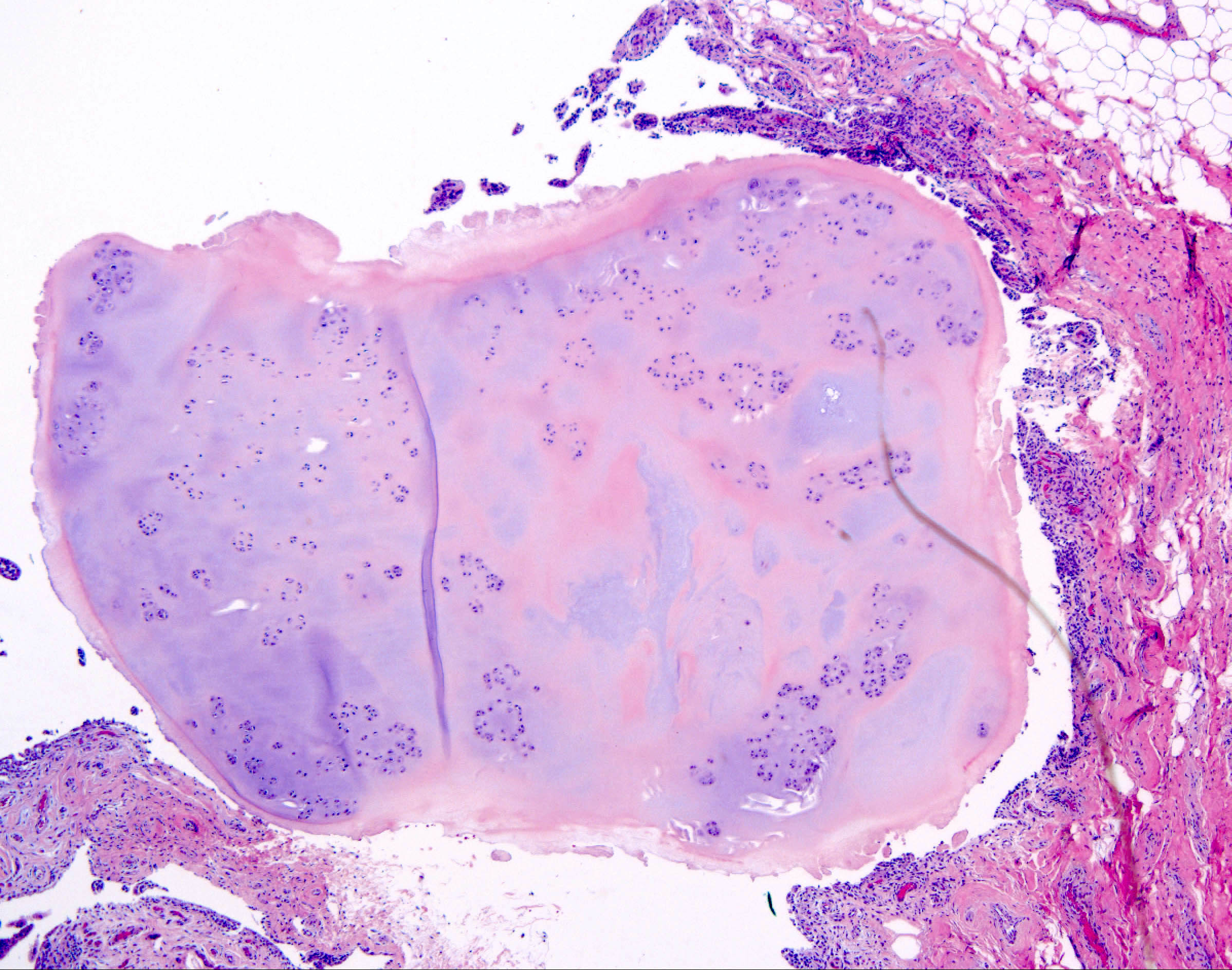 Pathology Outlines - Osteocartilaginous loose bodies