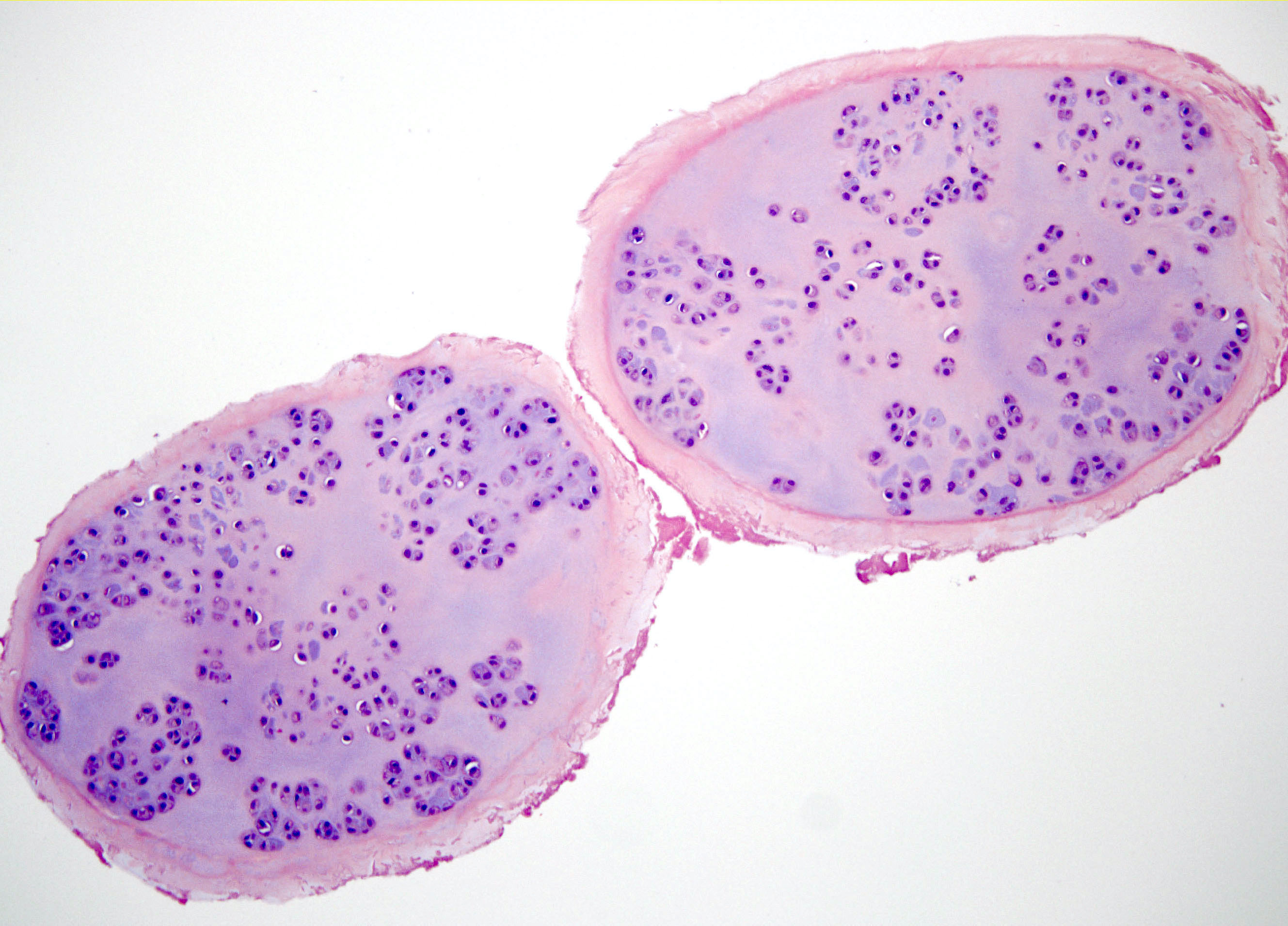 Pathology Outlines - Osteocartilaginous loose bodies