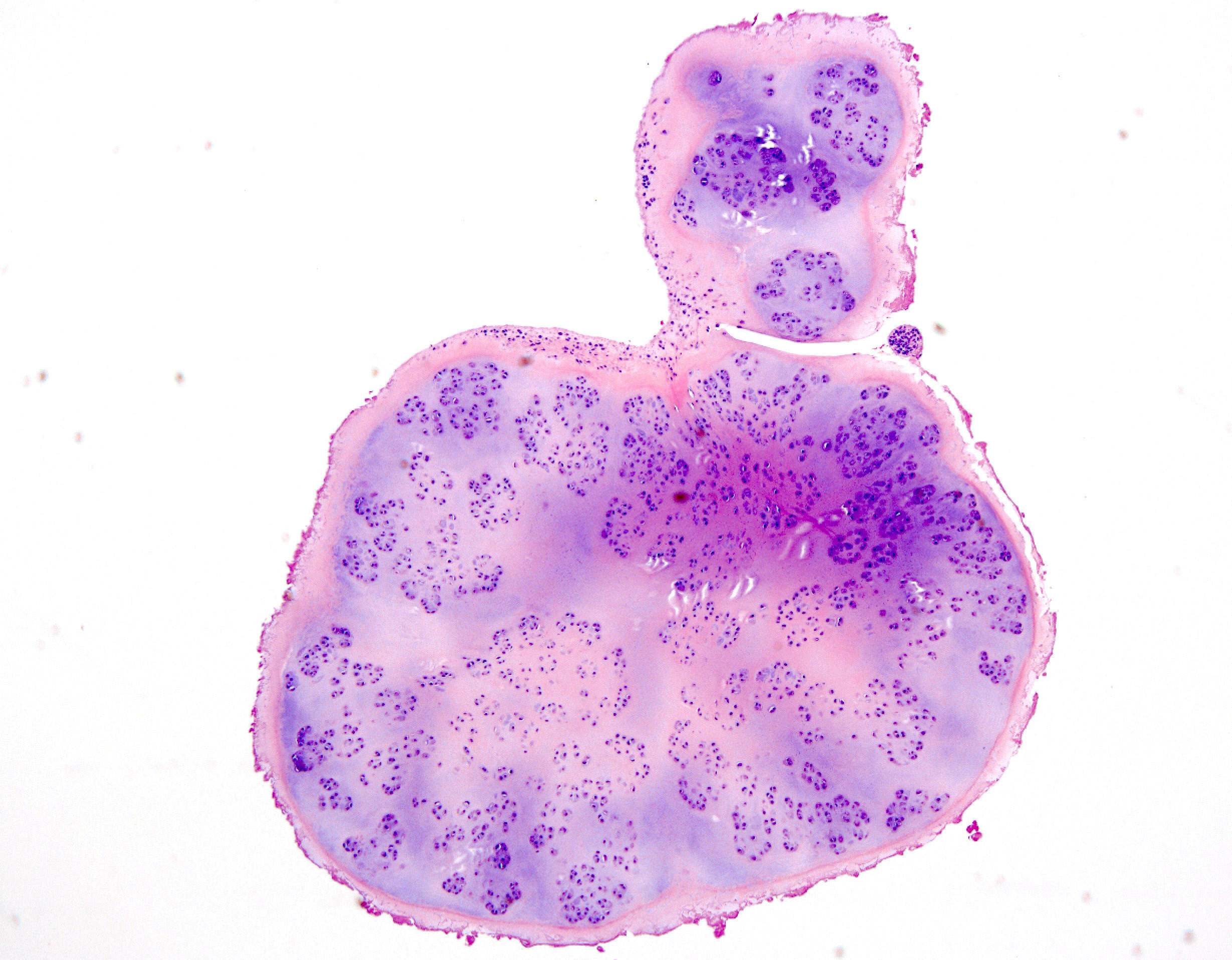 Pathology Outlines - Osteocartilaginous loose bodies