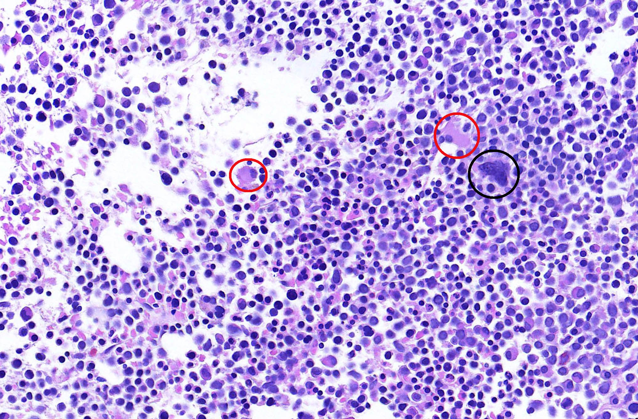 Pathology Outlines - MDS prognostic scoring