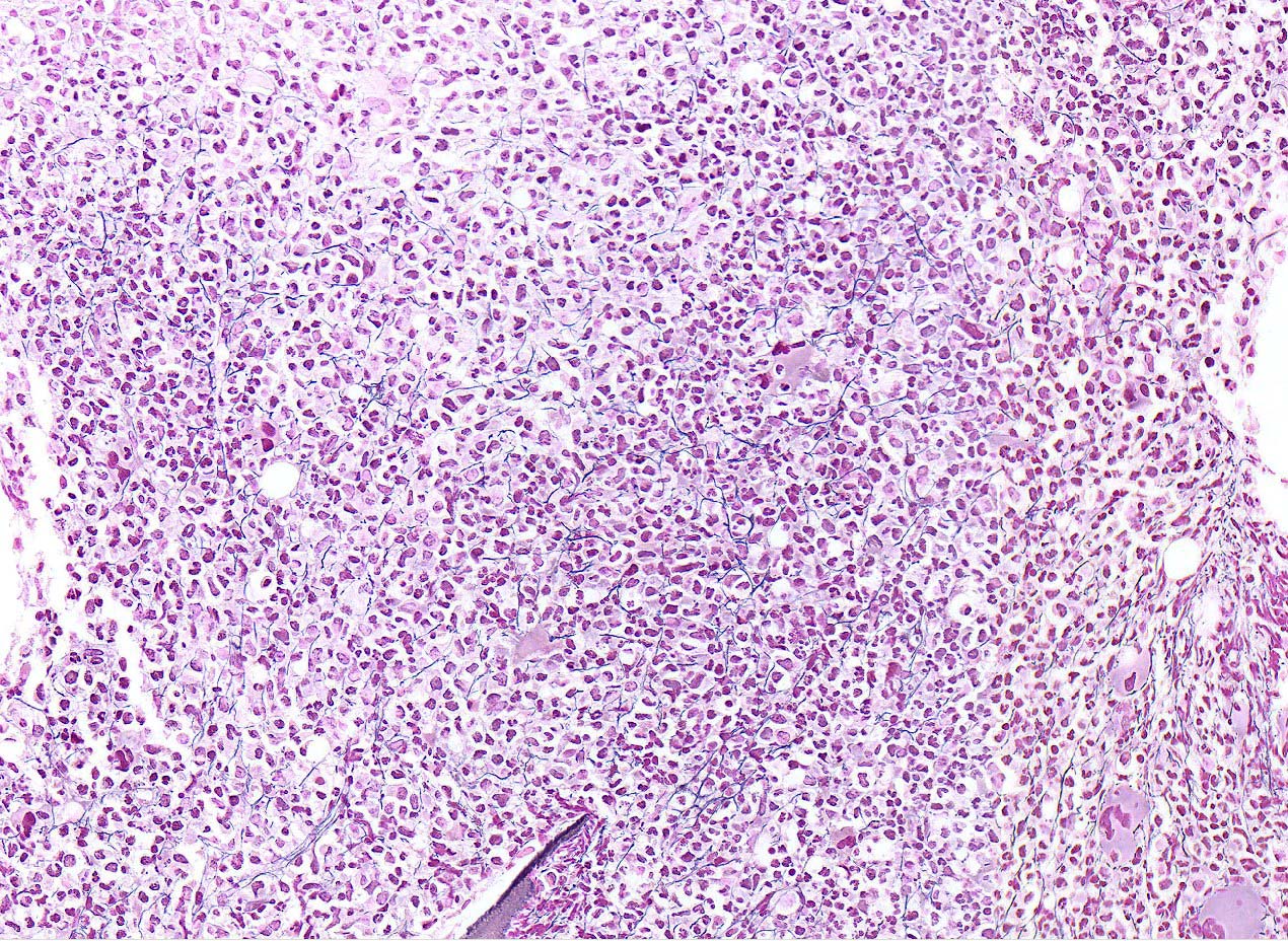 Pathology Outlines - MDS prognostic scoring