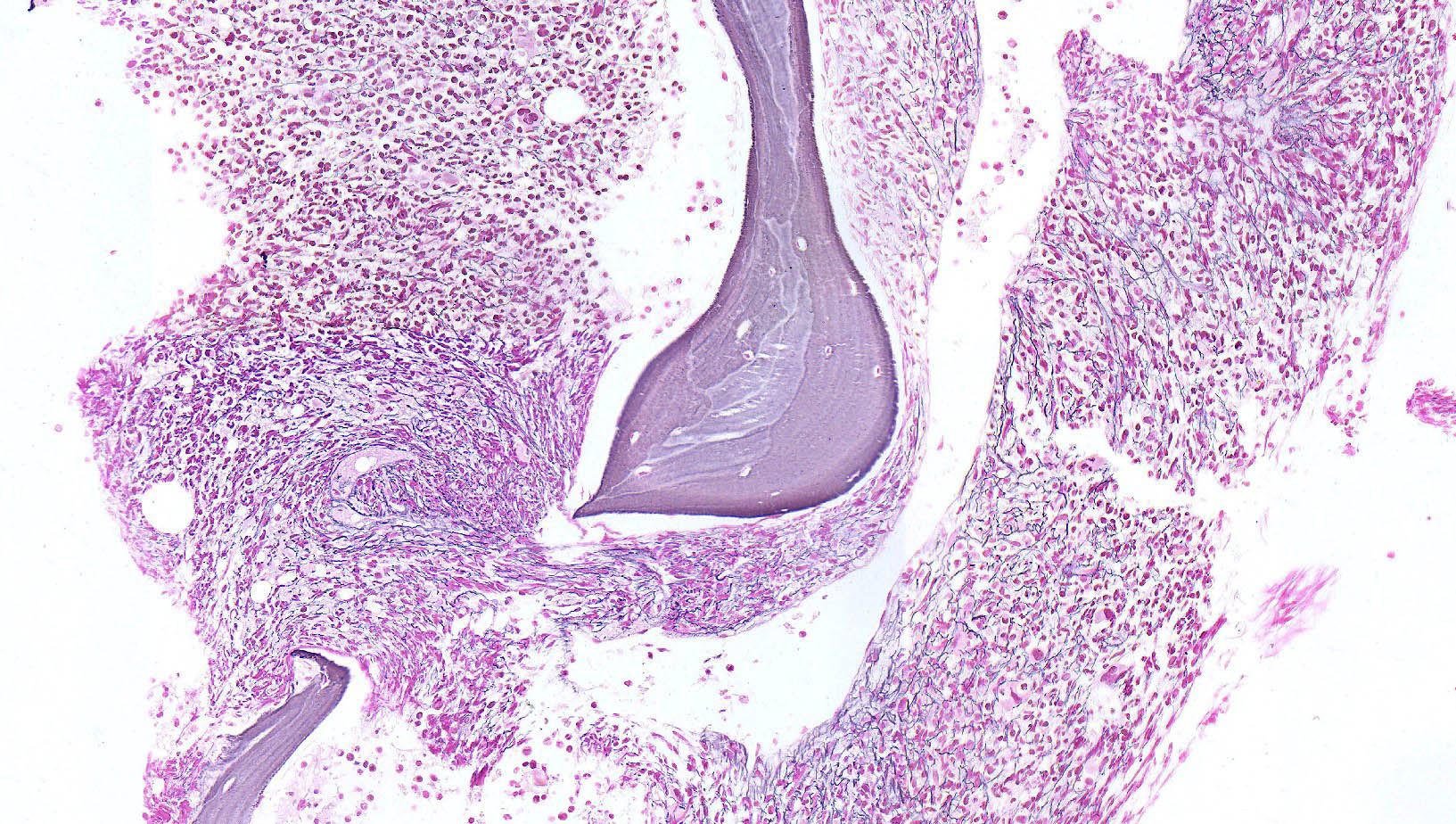 Pathology Outlines - MDS prognostic scoring