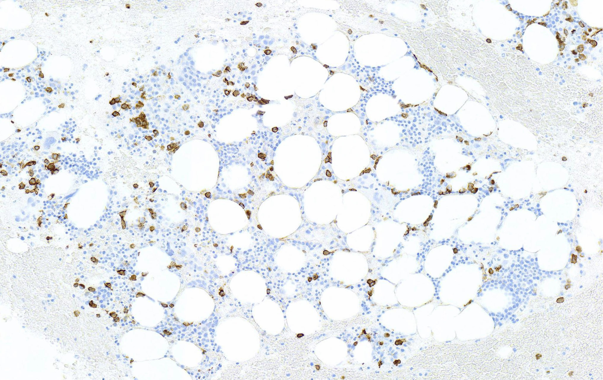 Pathology Outlines - MDS prognostic scoring