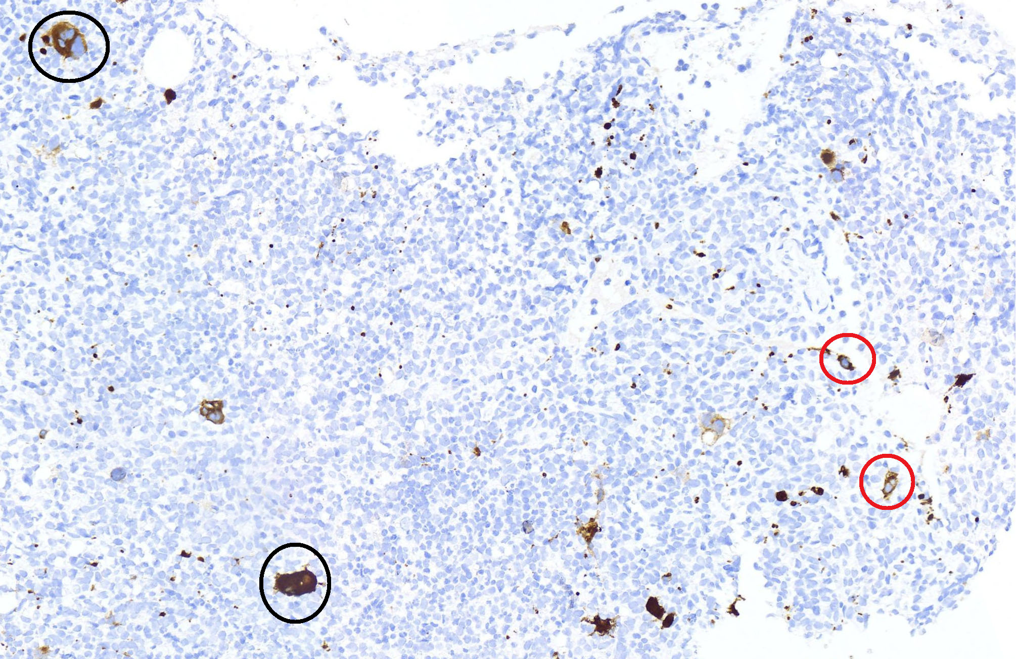 Pathology Outlines - MDS prognostic scoring