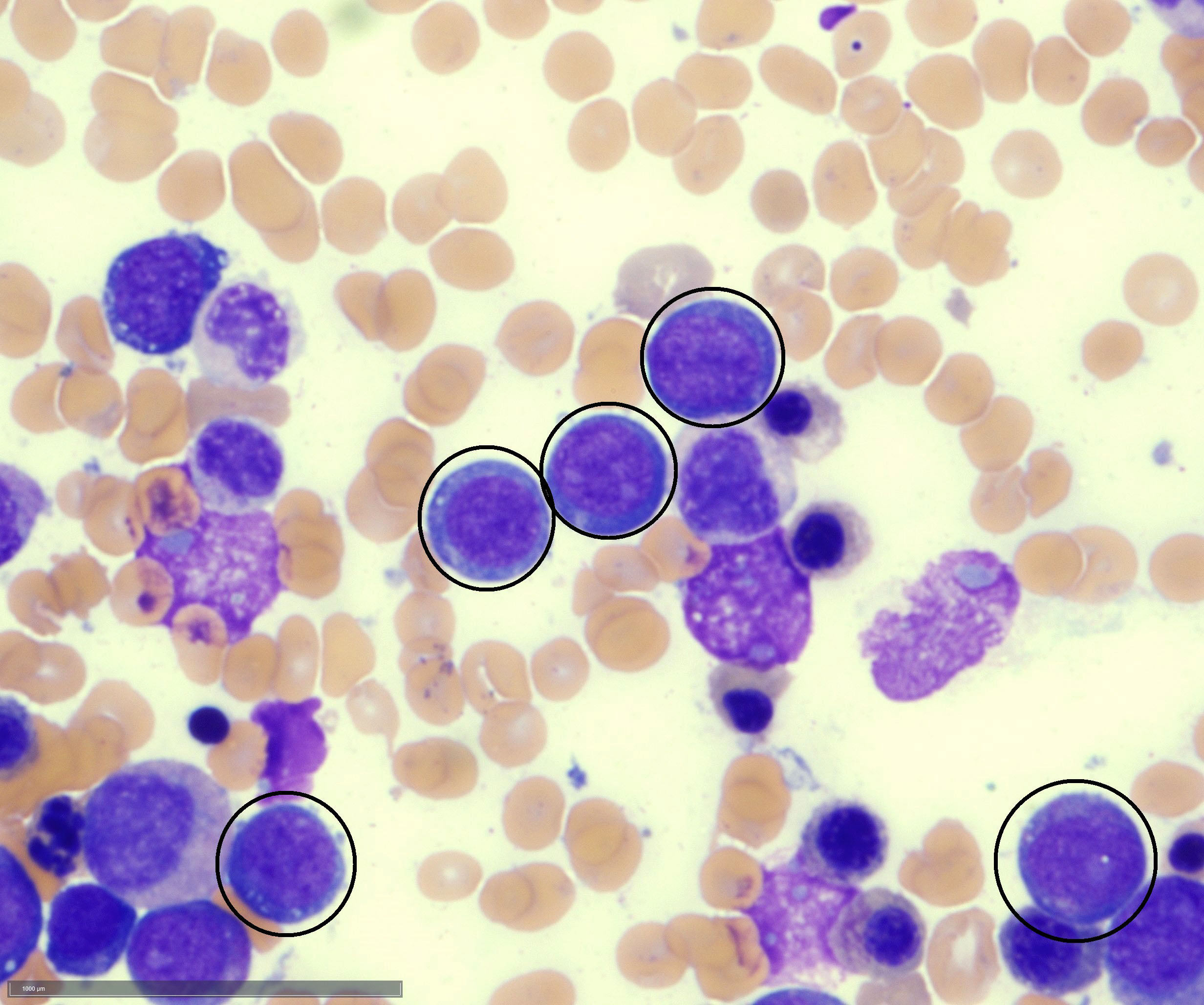 Pathology Outlines - MDS prognostic scoring