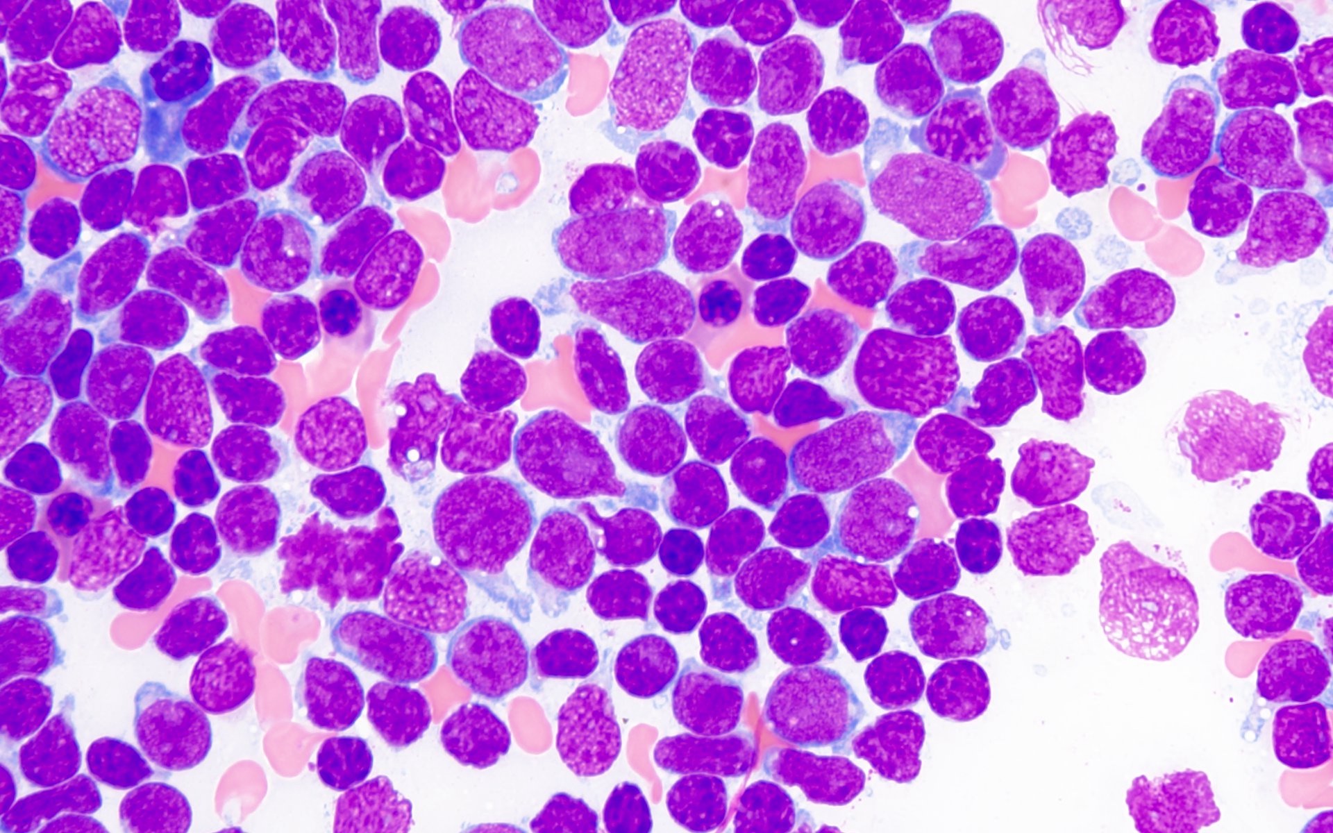 Pathology Outlines - with iAMP21