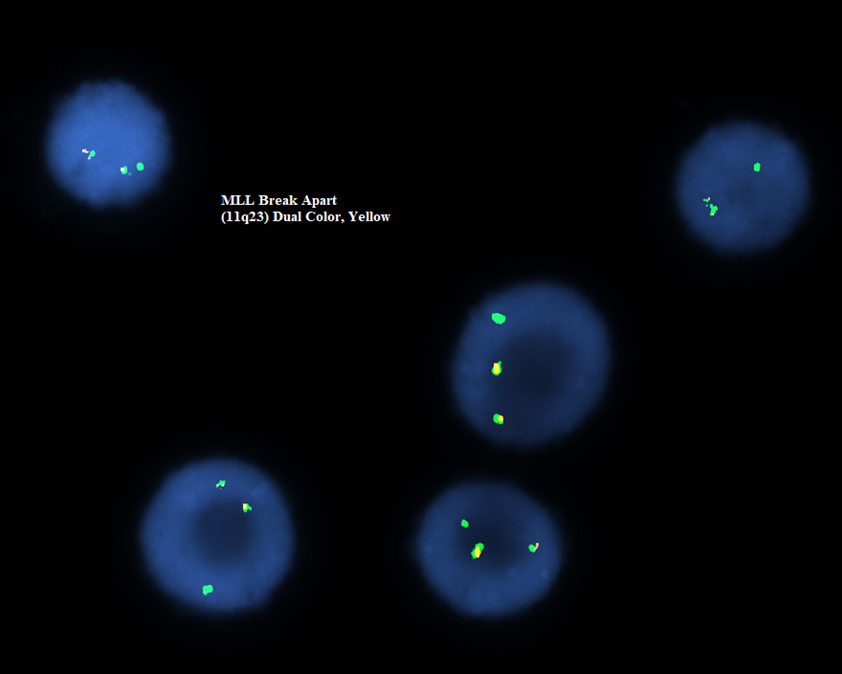 Pathology Outlines - AML with other KMT2A rearrangements