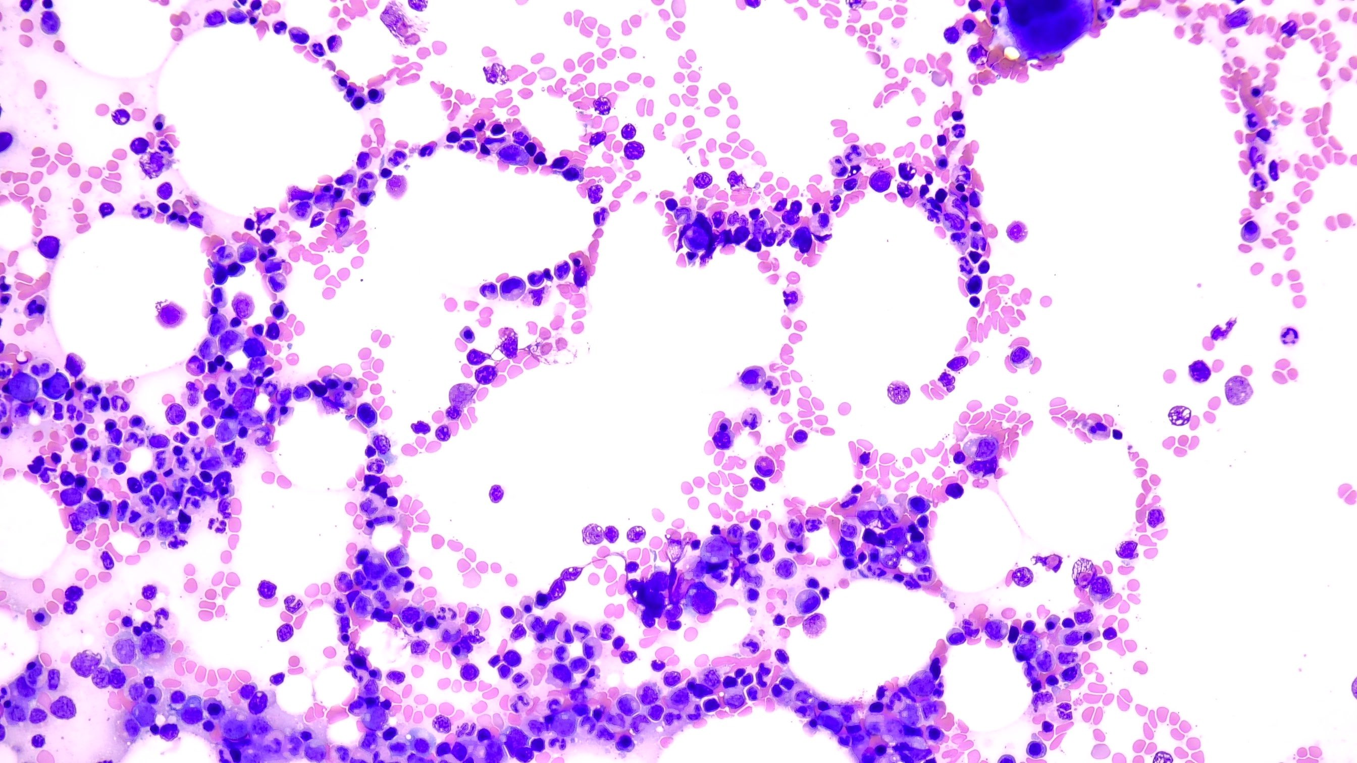 Pathology Outlines - Clonal cytopenia of undetermined significance (CCUS)