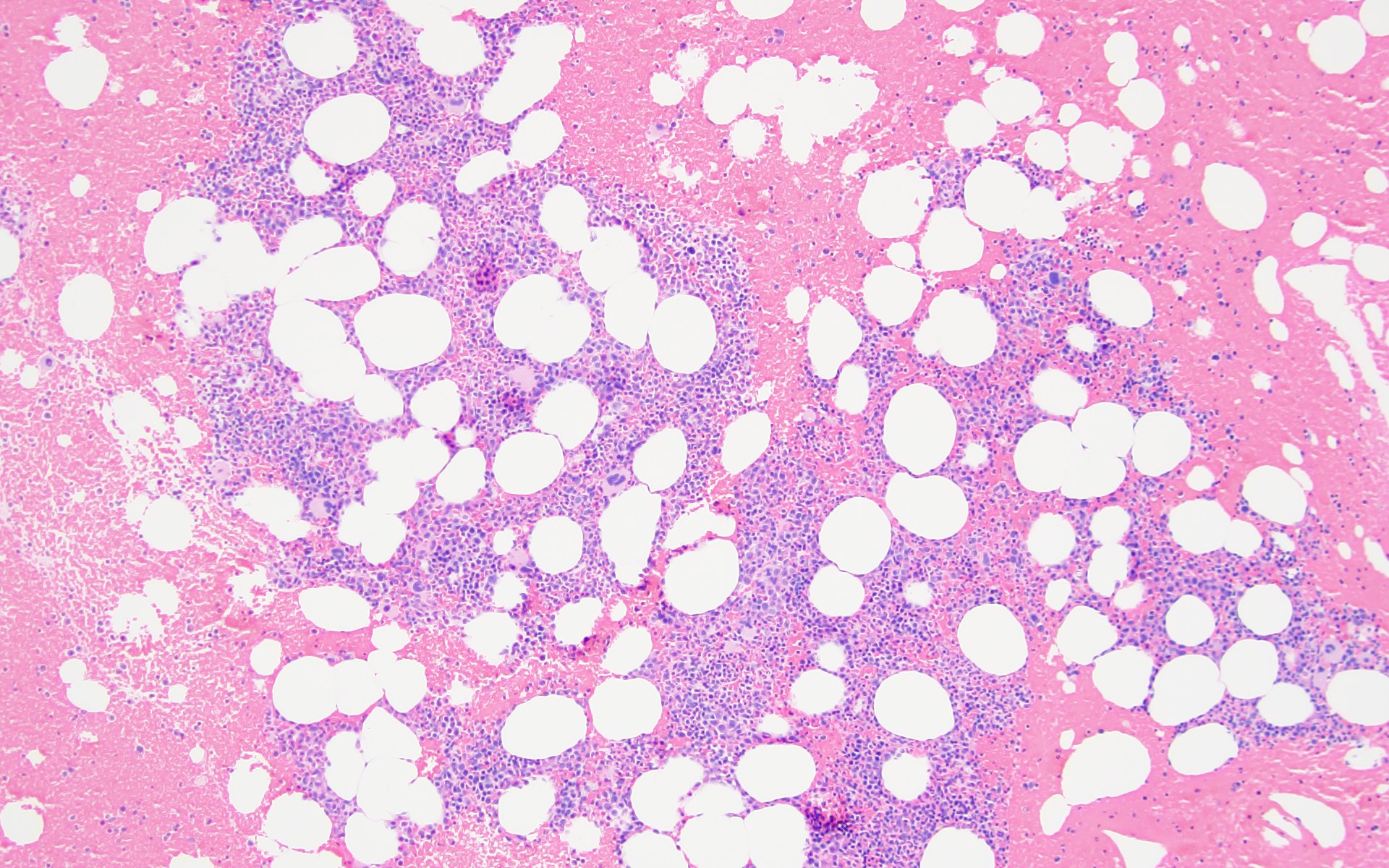 Pathology Outlines - Clonal hematopoiesis of indeterminate potential (CHIP)