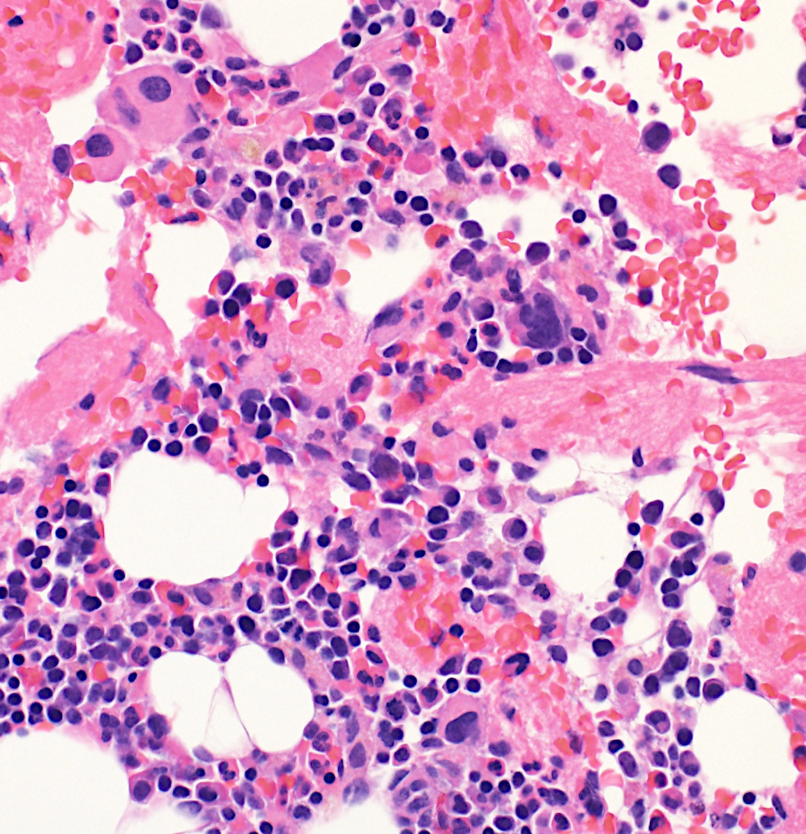 Pathology Outlines - Myeloid neoplasms with germline SAMD9 mutation