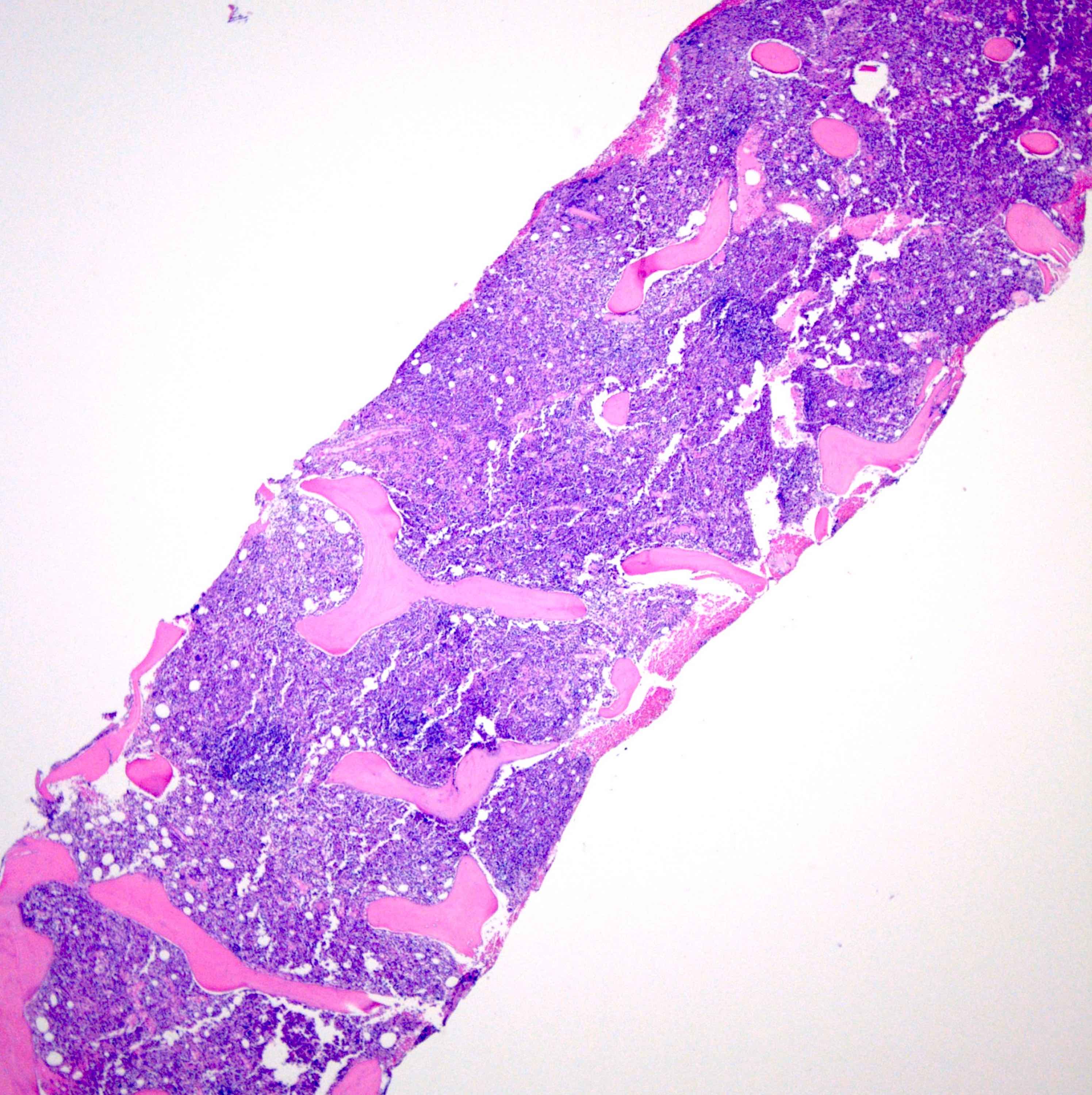 Pathology Outlines - Autoimmune myelofibrosis (AIMF)