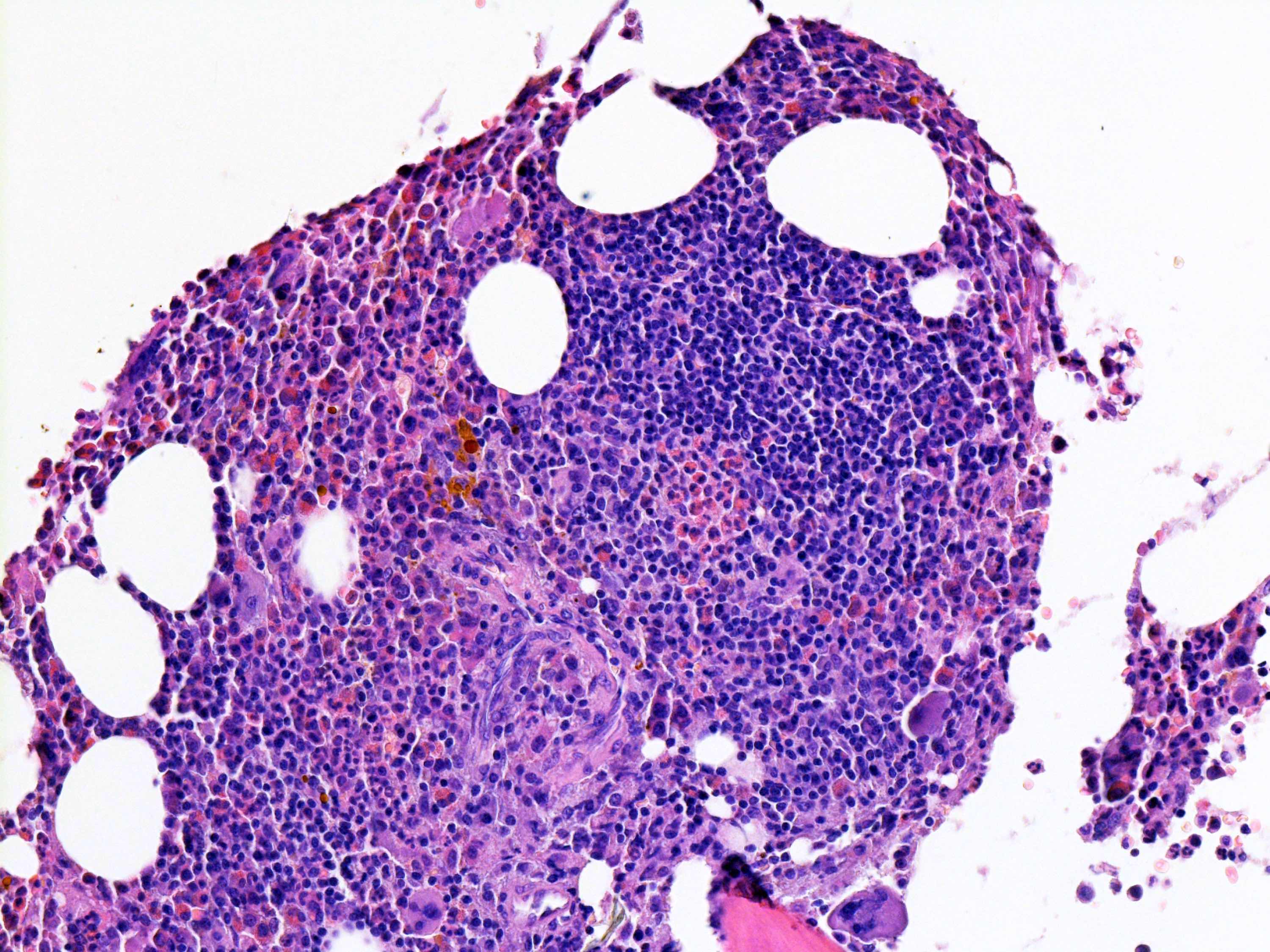 Pathology Outlines - Autoimmune myelofibrosis (AIMF)