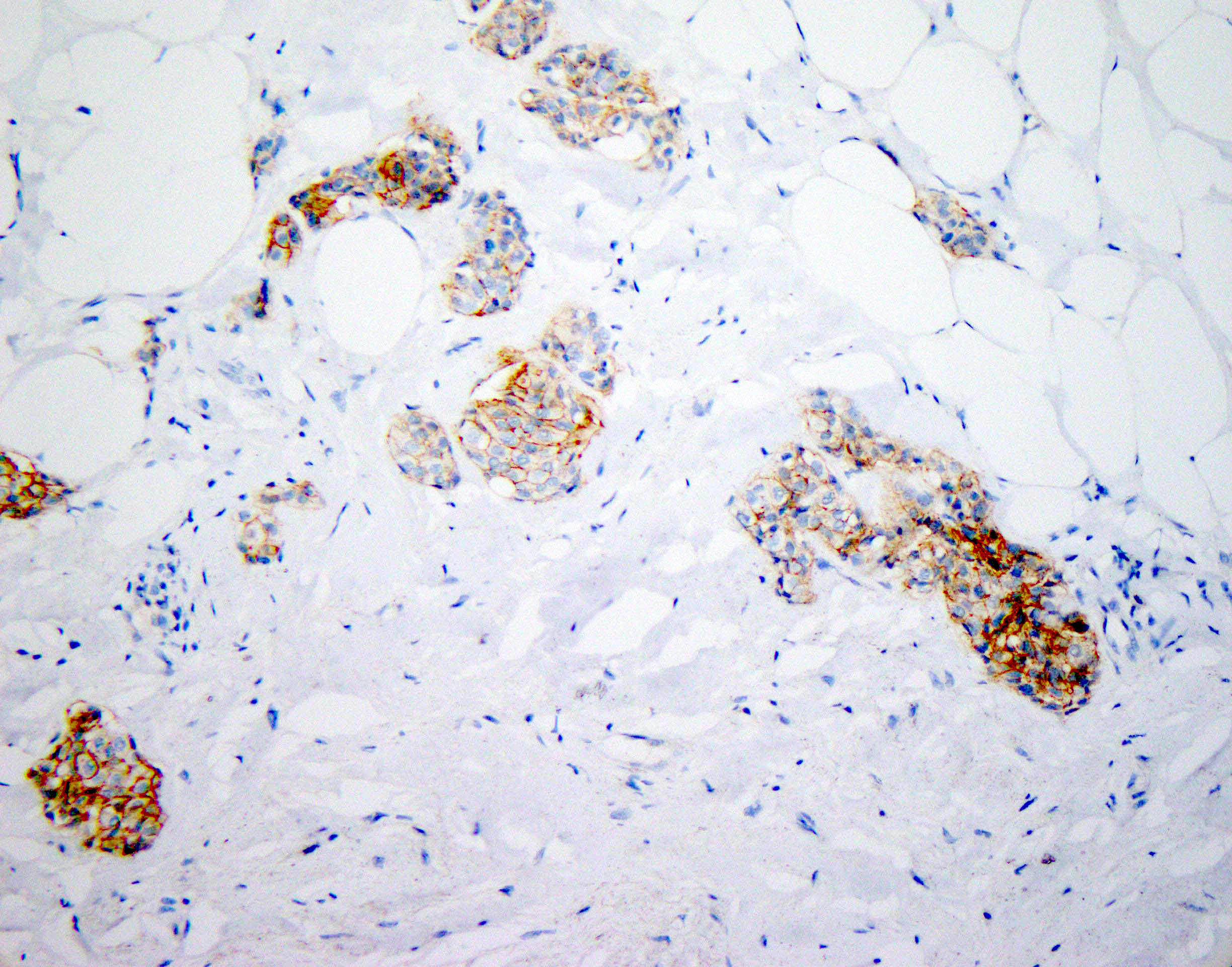 Pathology Outlines - HER2 low breast cancer