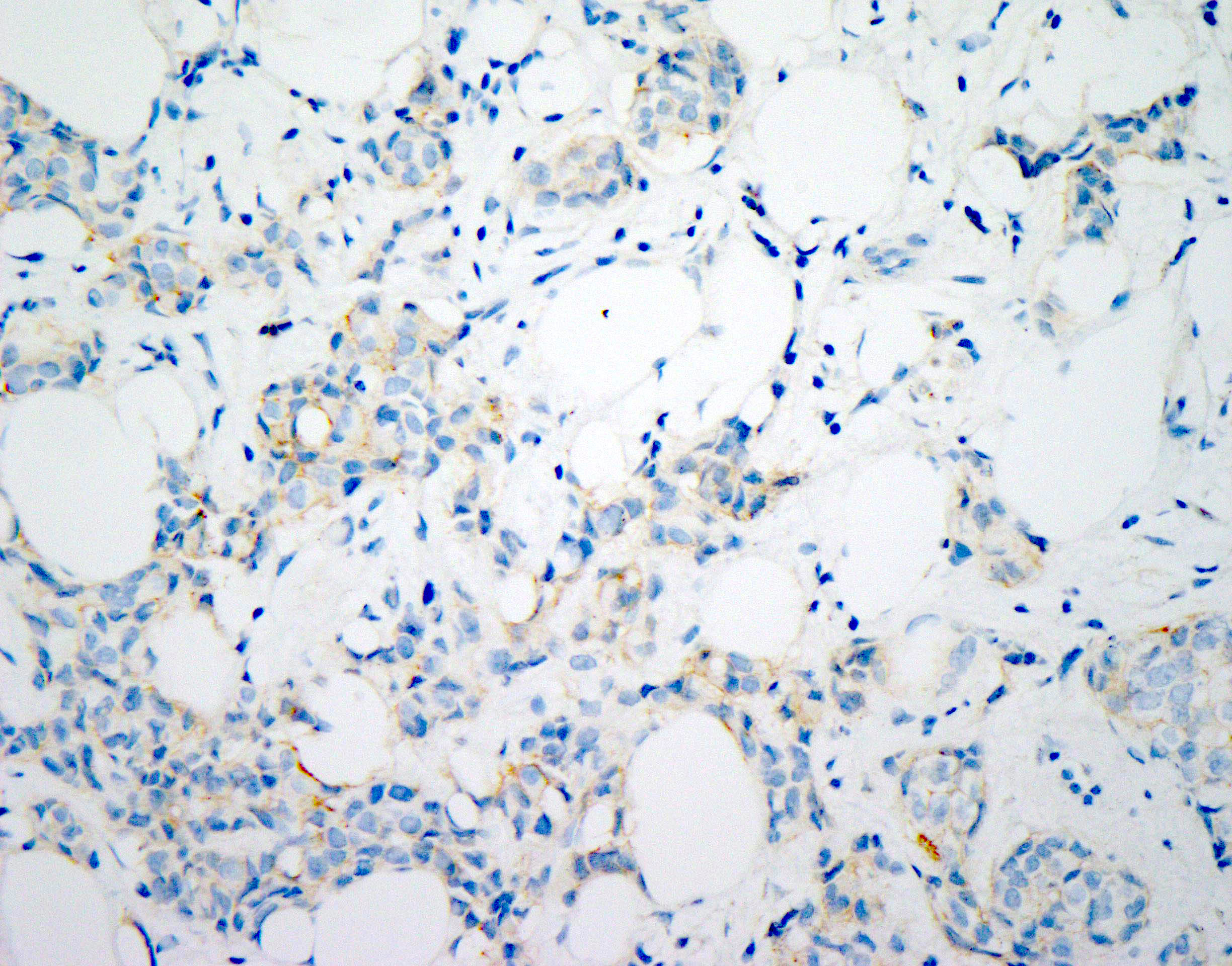 Pathology Outlines - HER2 low breast cancer