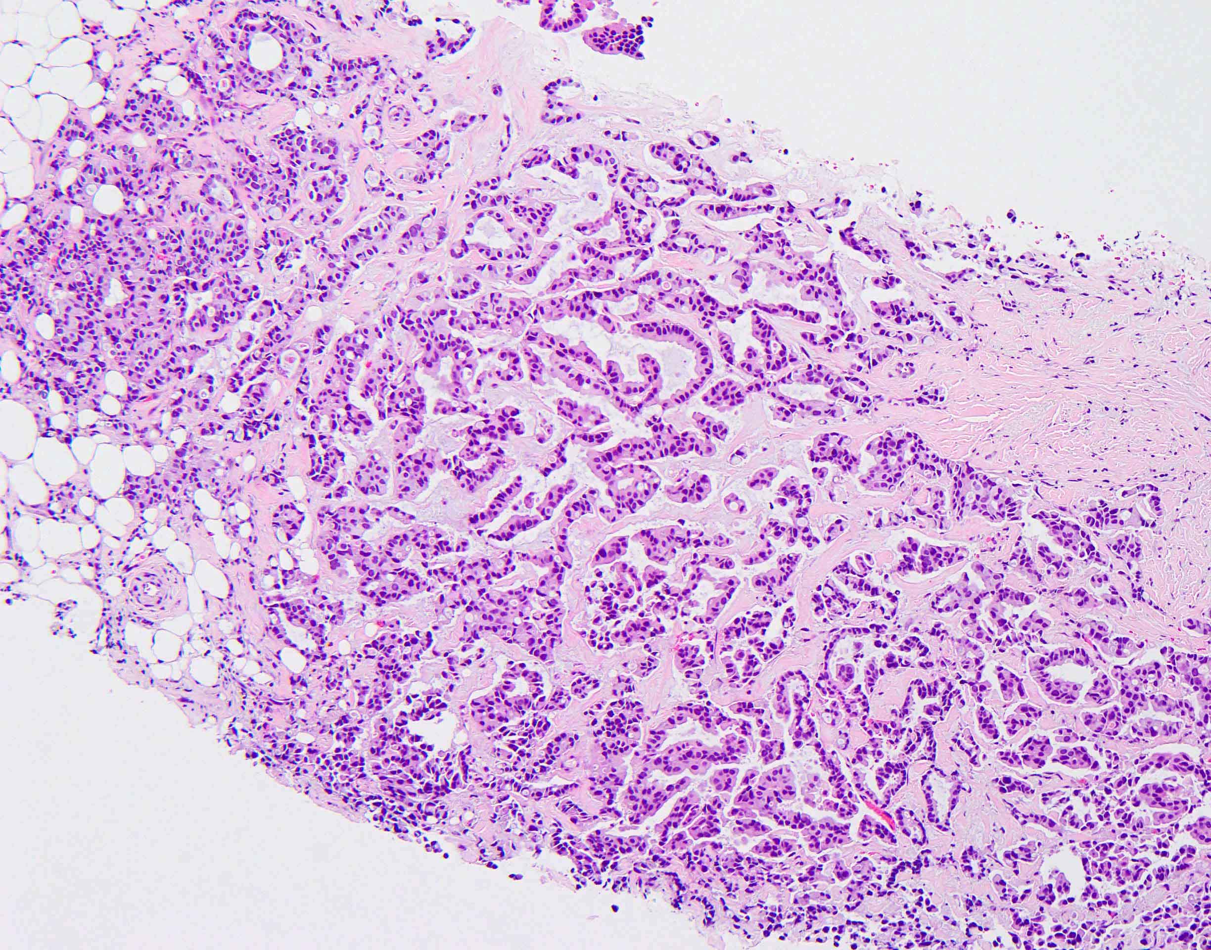 Pathology Outlines - HER2 low breast cancer