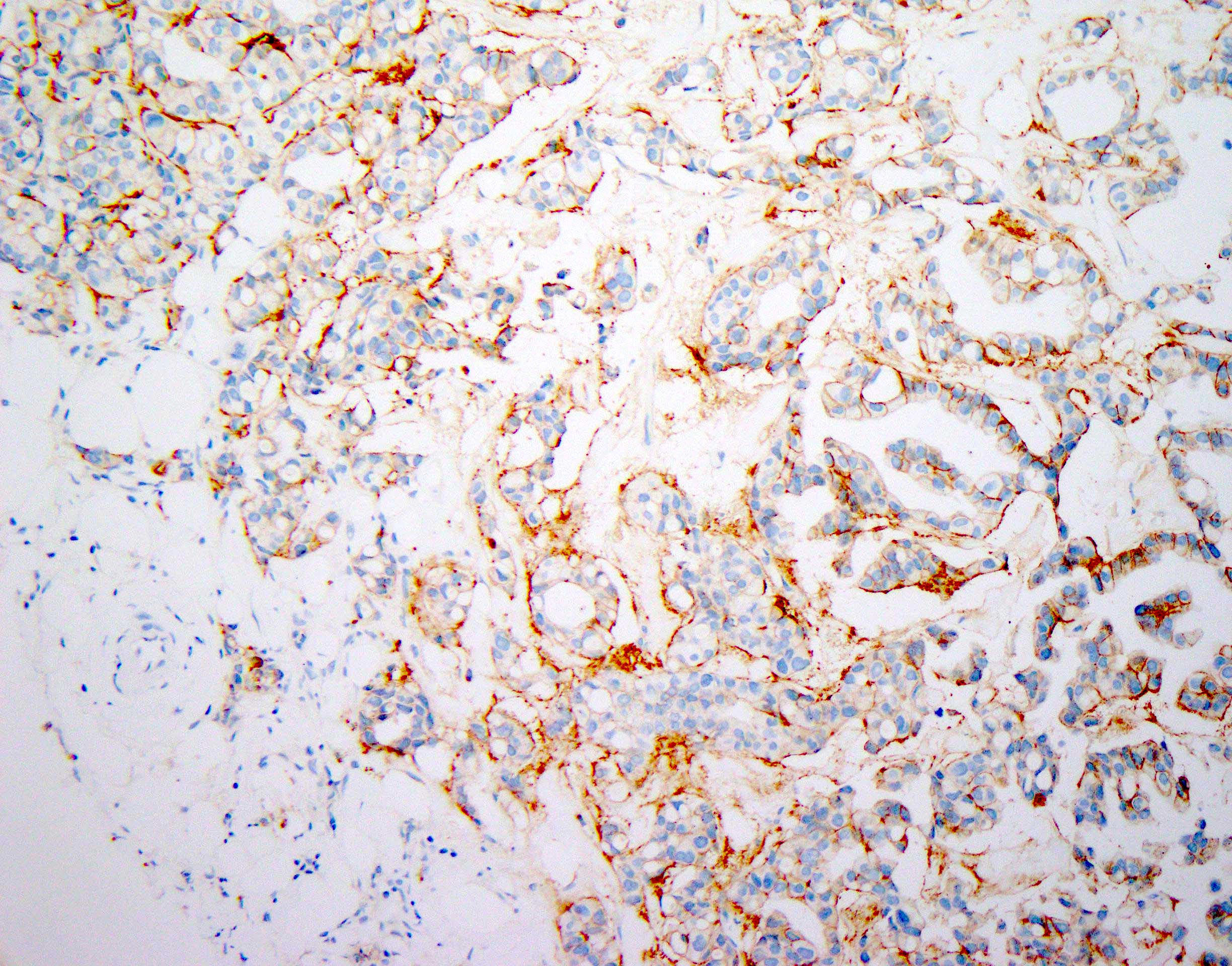 Pathology Outlines - HER2 low breast cancer