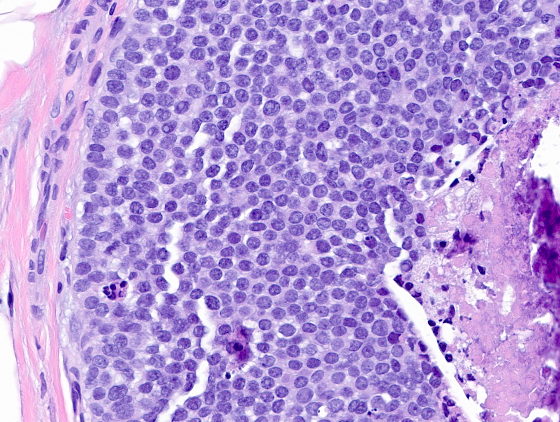 Pathology Outlines - LCIS florid