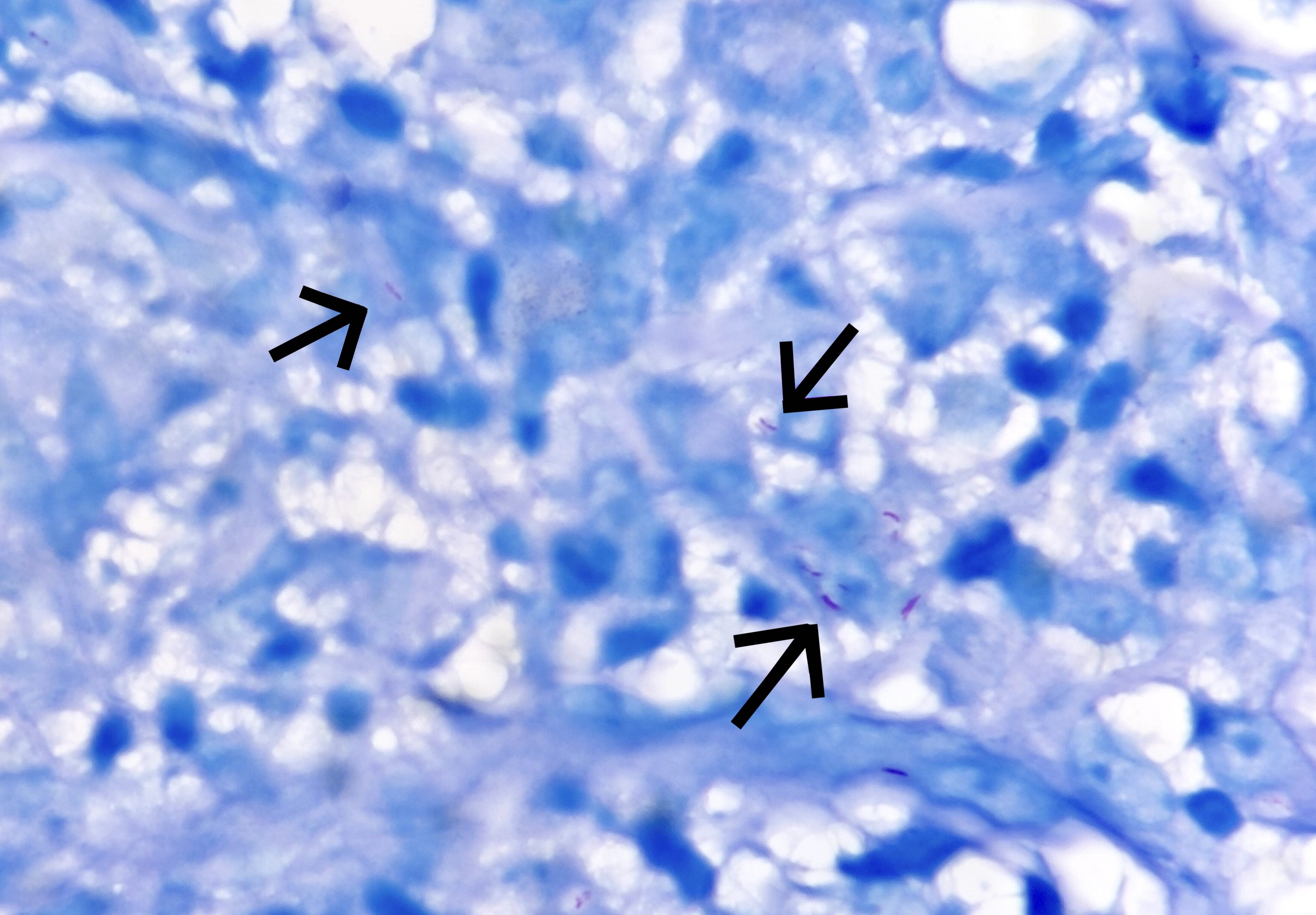 Pathology Outlines - Tuberculosis