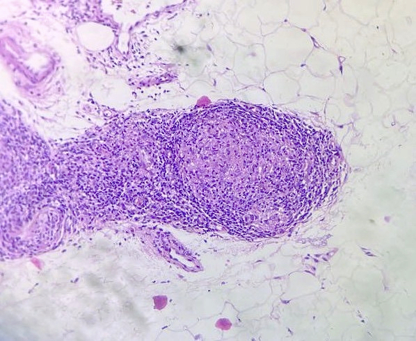 Pathology Outlines - Tuberculosis