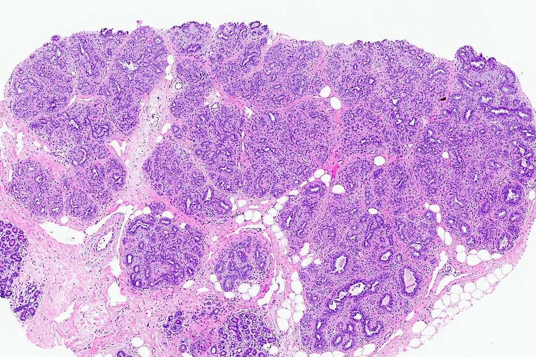 Pathology Outlines - Adenomyoepithelial adenosis