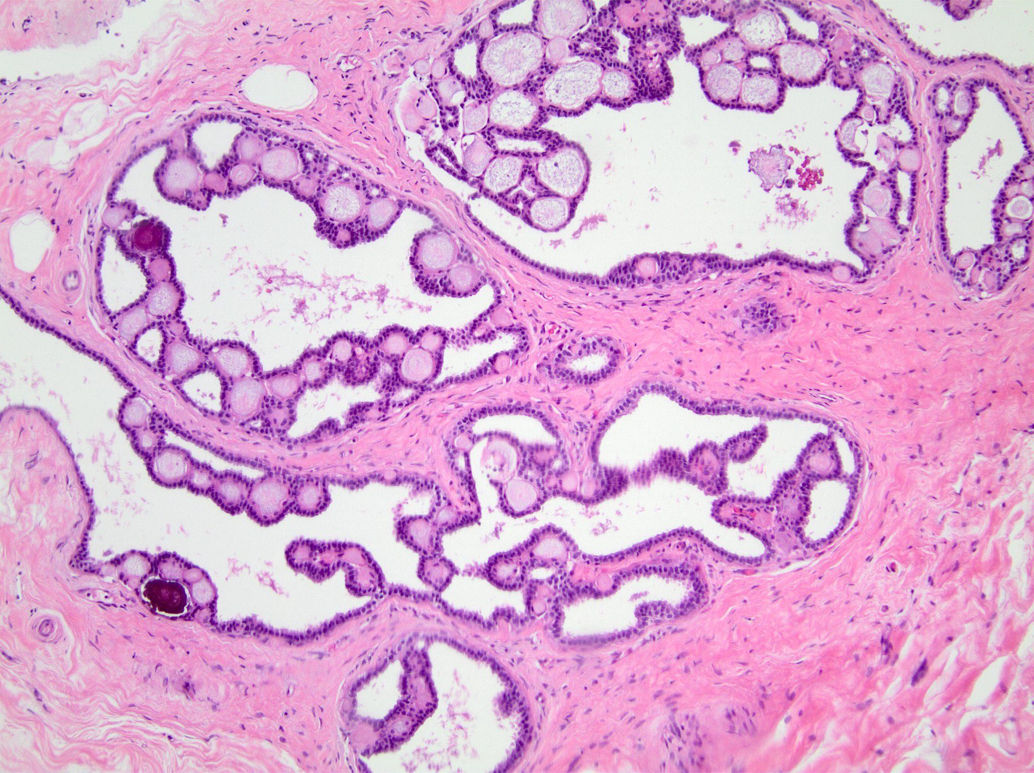 Pathology Outlines - Microcalcifications