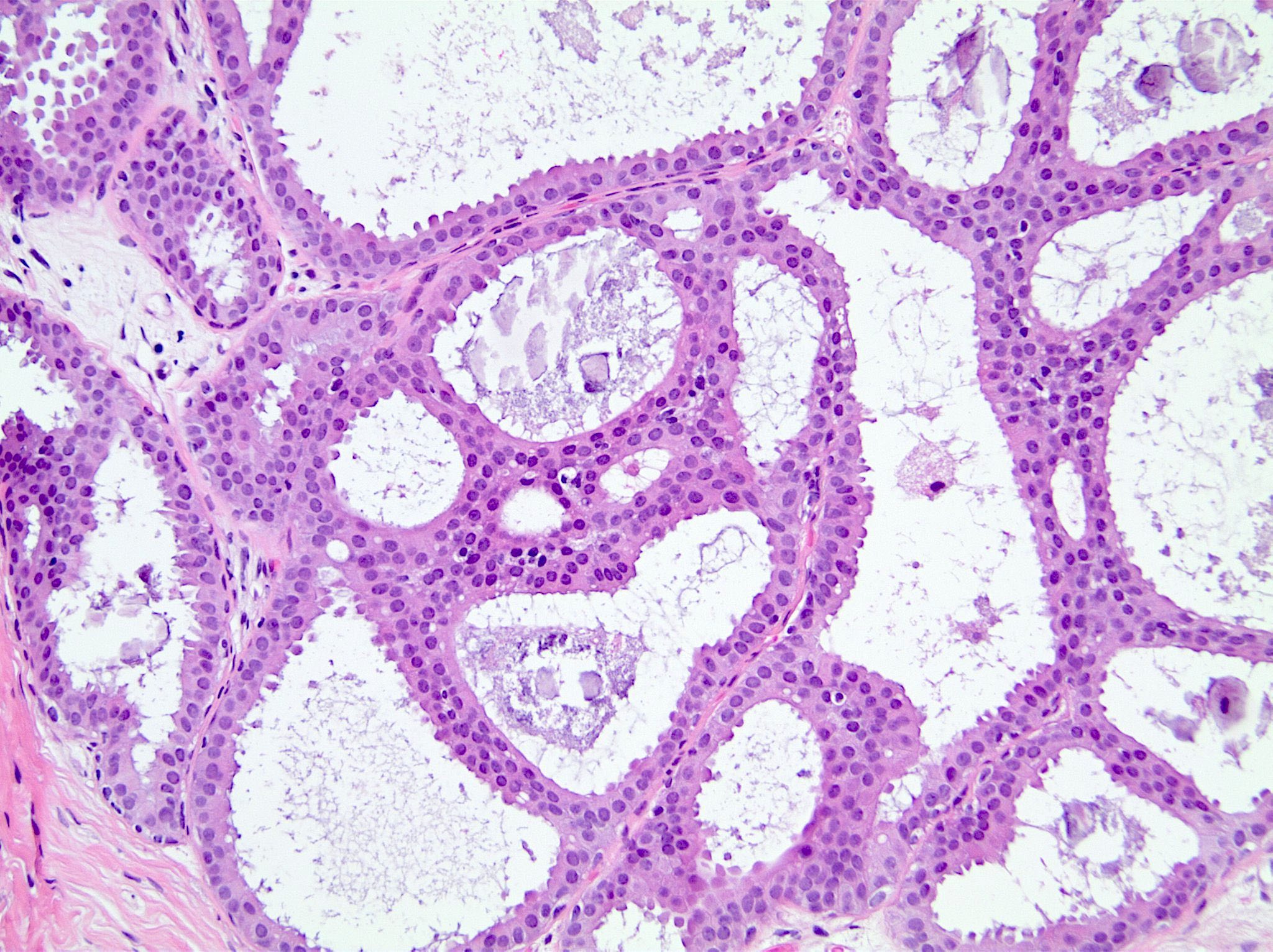 Pathology Outlines - Microcalcifications