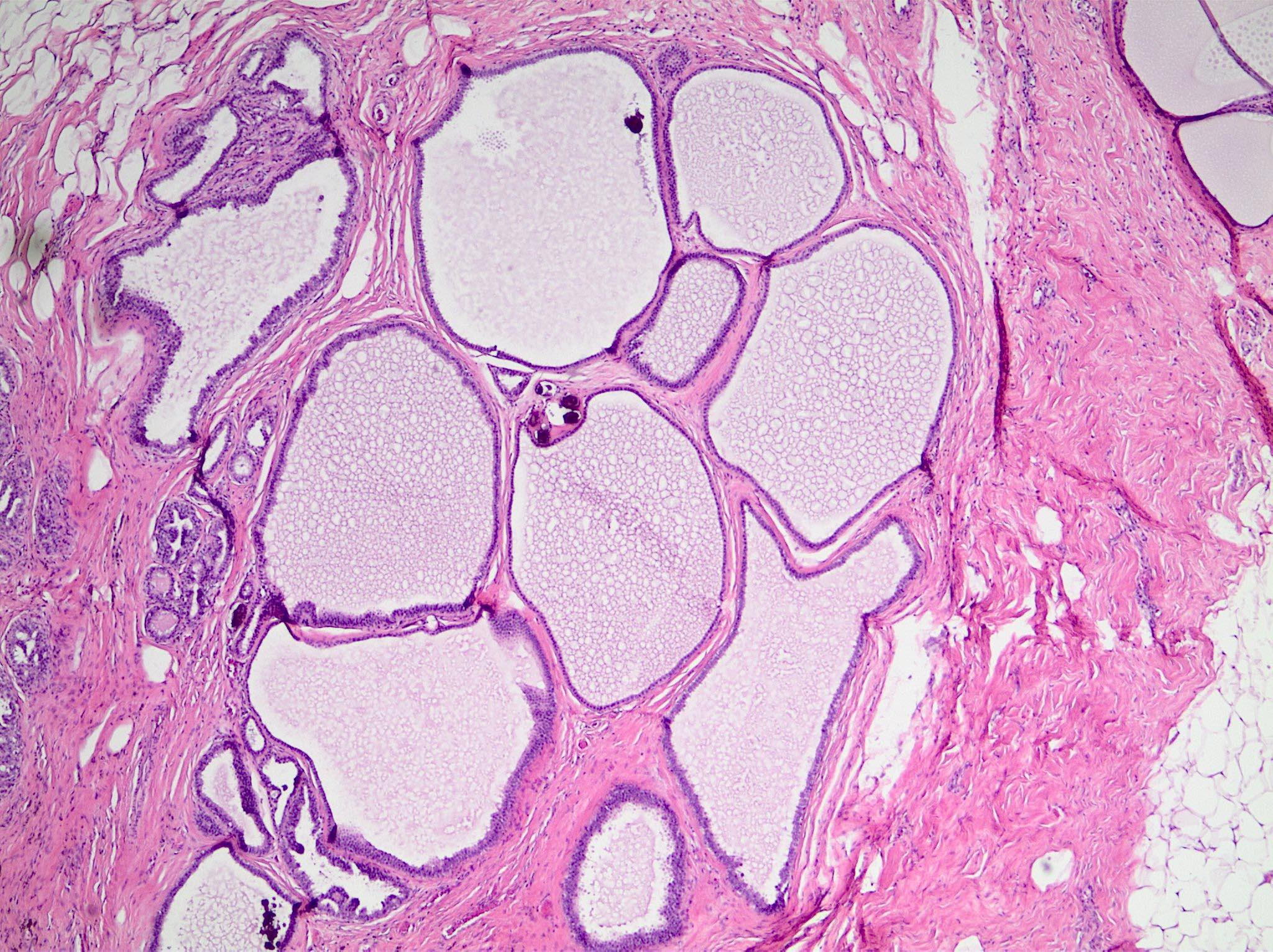 Pathology Outlines - Microcalcifications