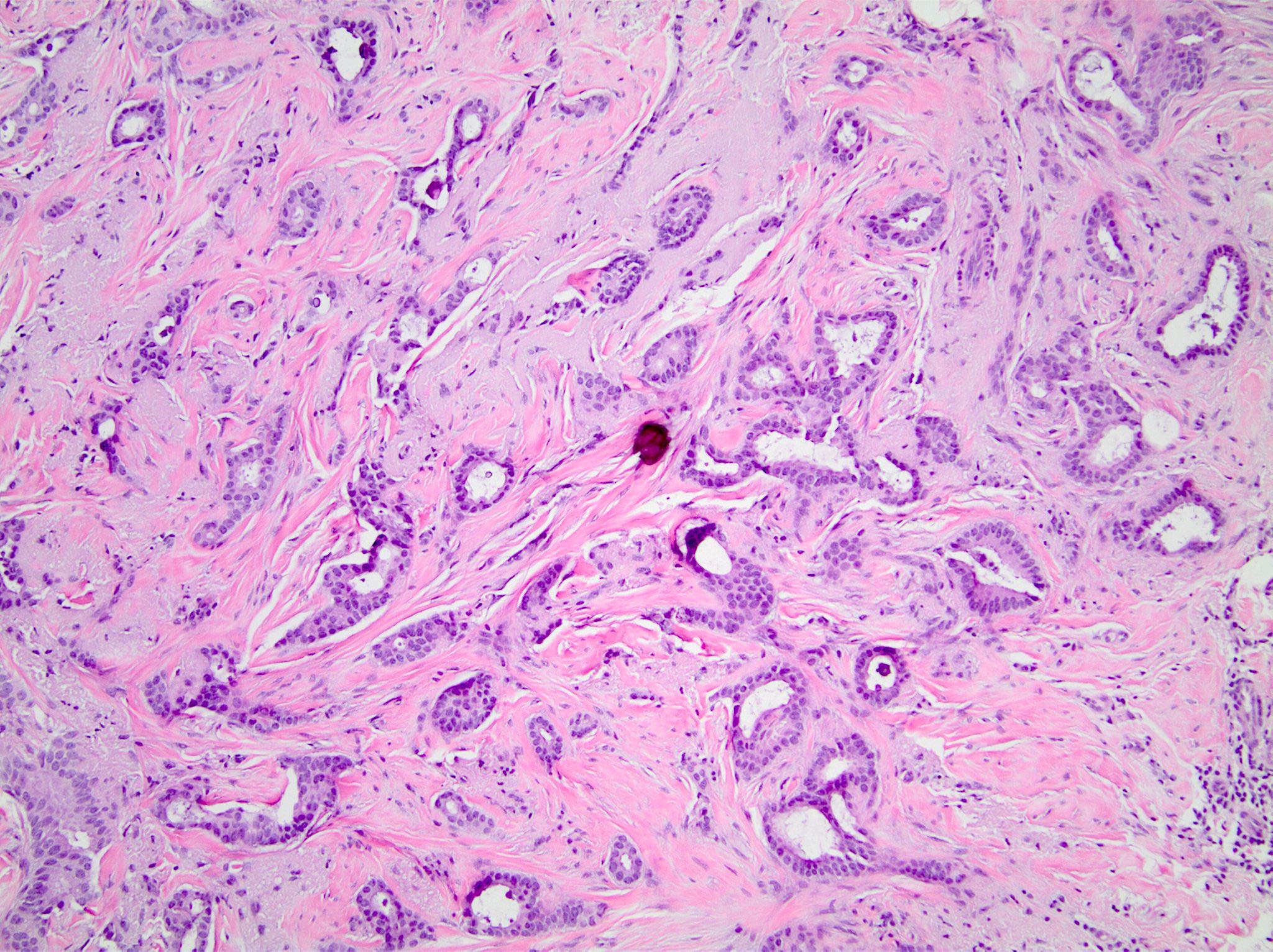 Pathology Outlines - Microcalcifications