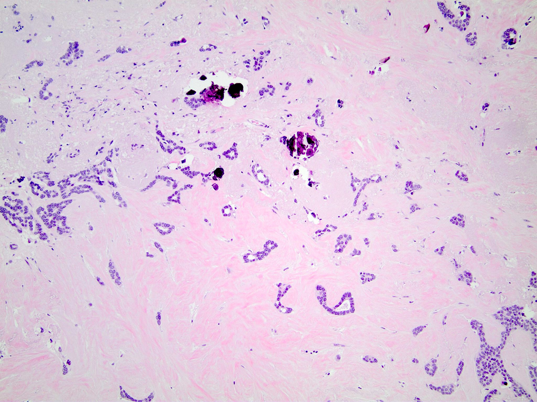 Pathology Outlines - Microcalcifications