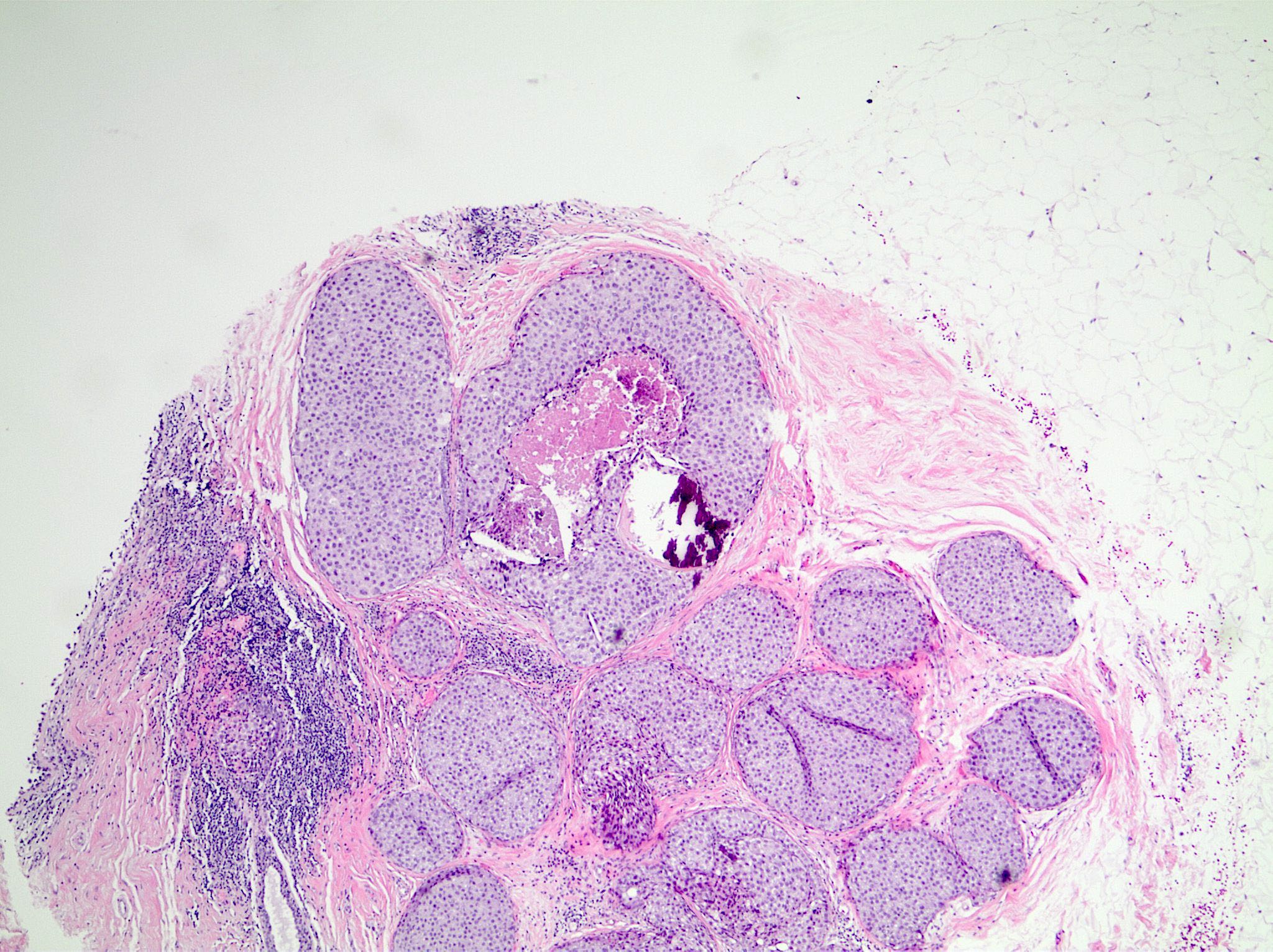 Pathology Outlines - Microcalcifications