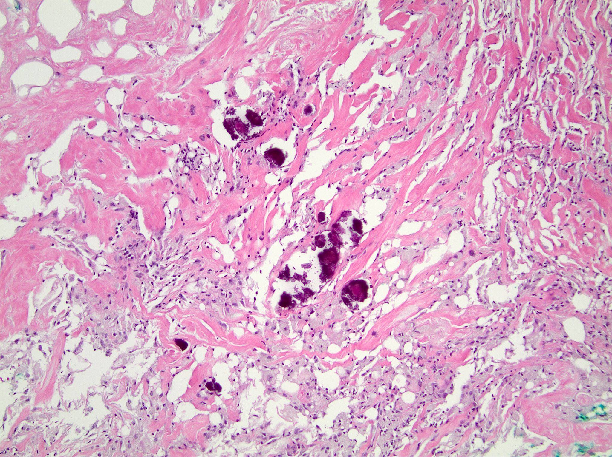 Pathology Outlines - Microcalcifications