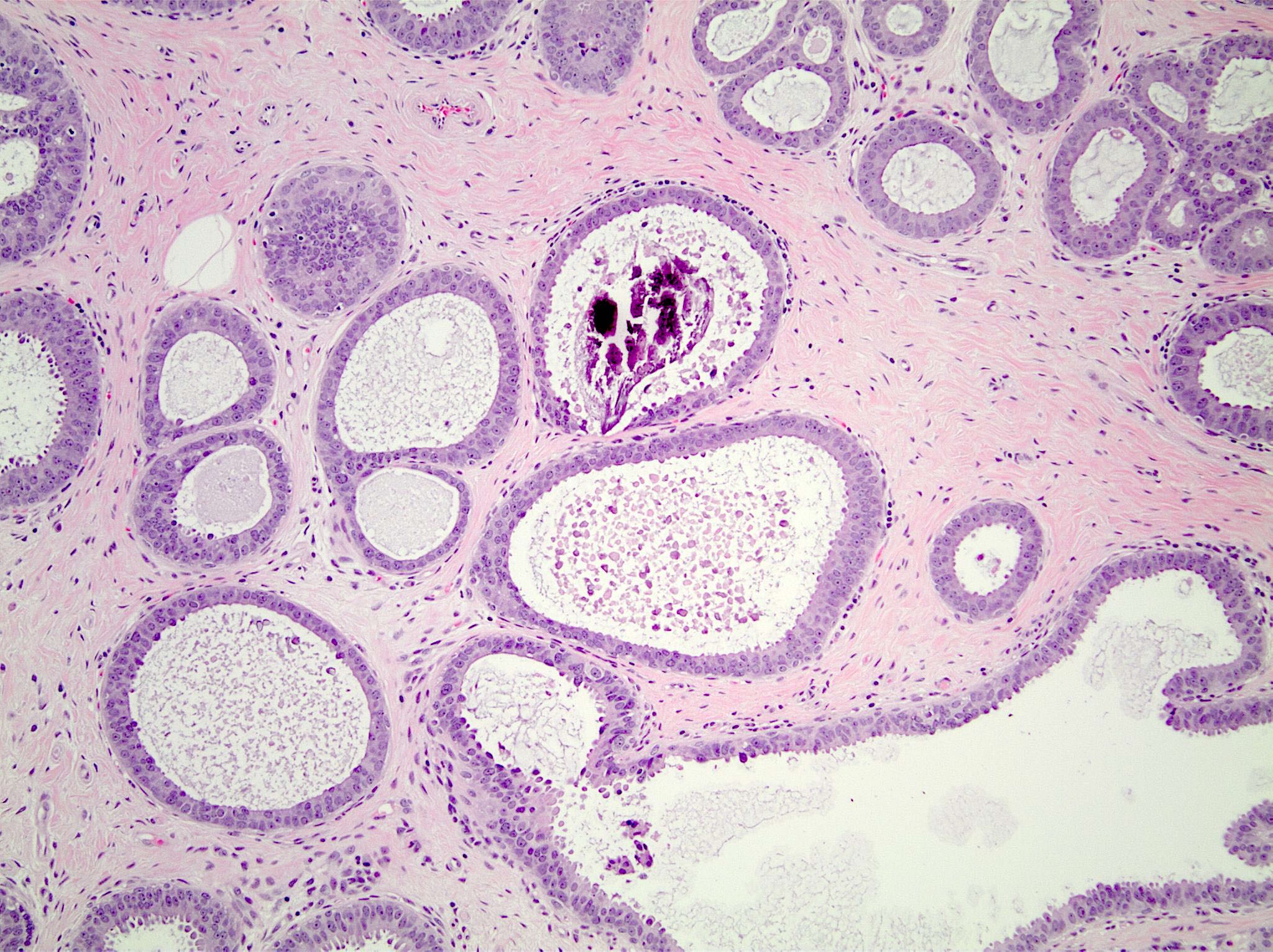 Pathology Outlines - Microcalcifications