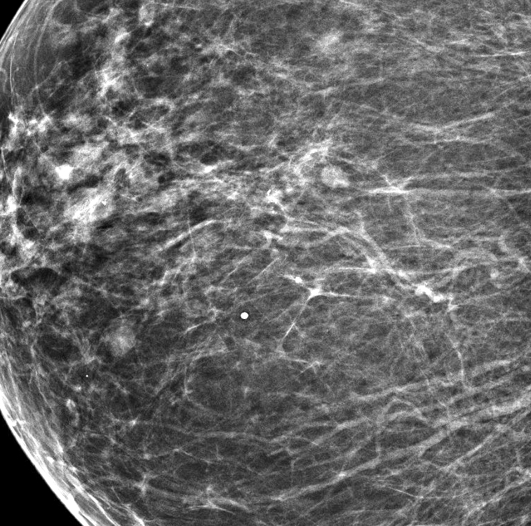 Pathology Outlines - Microcalcifications