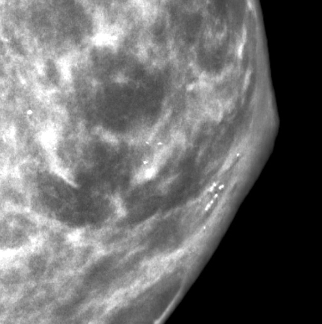 Pathology Outlines - Microcalcifications